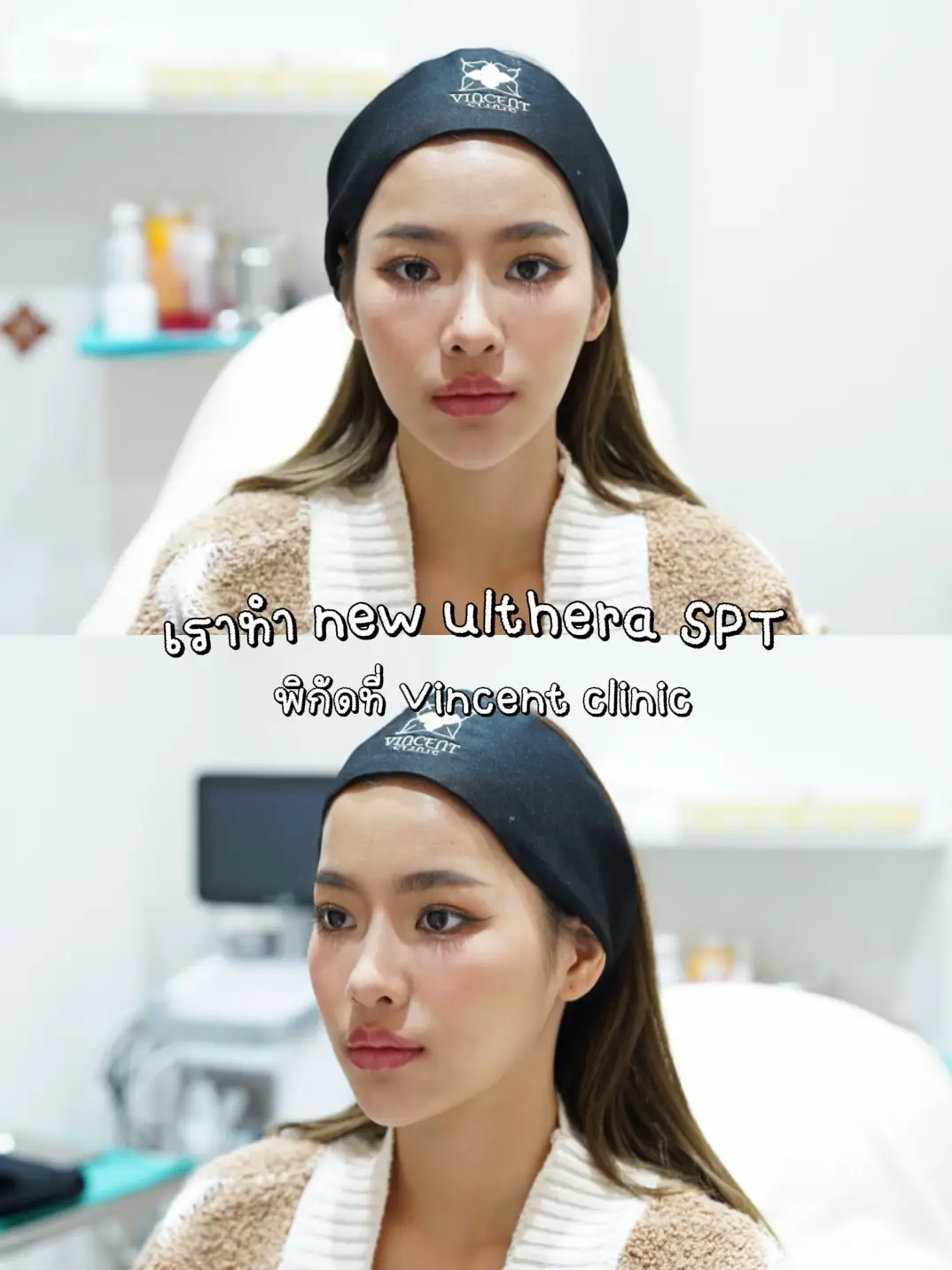 ไหน ! มาลอง ulthera ที่เค้าว่าปังหน่อยสิ้ ☺️ | แกลเลอรีที่โพสต์โดย วินเซนต์พารีวิว | Lemon8