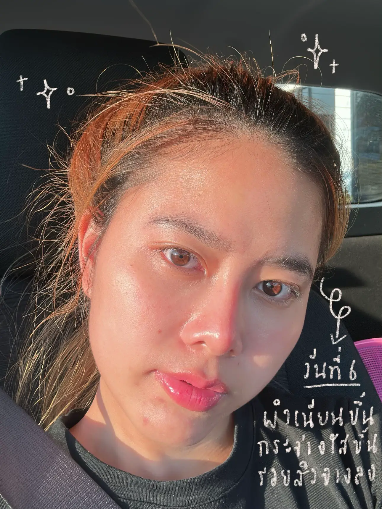 ฉีดชาแนลดียังไง ? ใครที่ต้องทำ ? ‼️🔥 | แกลเลอรีที่โพสต์โดย ssompns | Lemon8