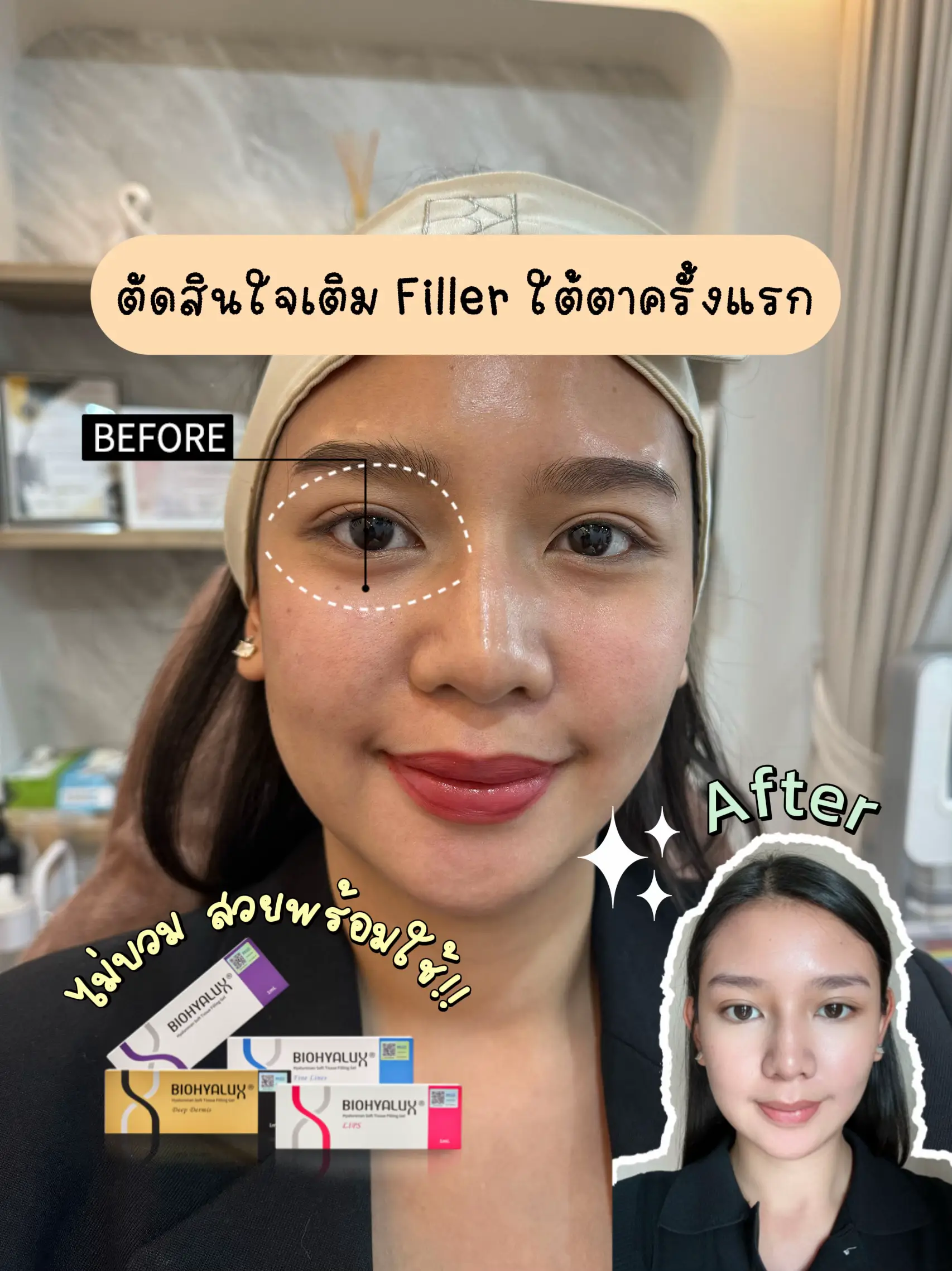 ฉีด Filler ใต้ตาครั้งแรก ถ้าดีแบบนี้ทำนานแล้ว!! | แกลเลอรีที่โพสต์โดย Annarisa | Lemon8