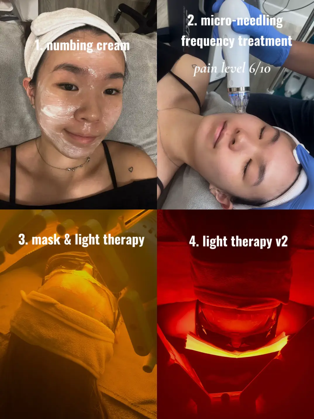 micro-needling - Lemon8 Search