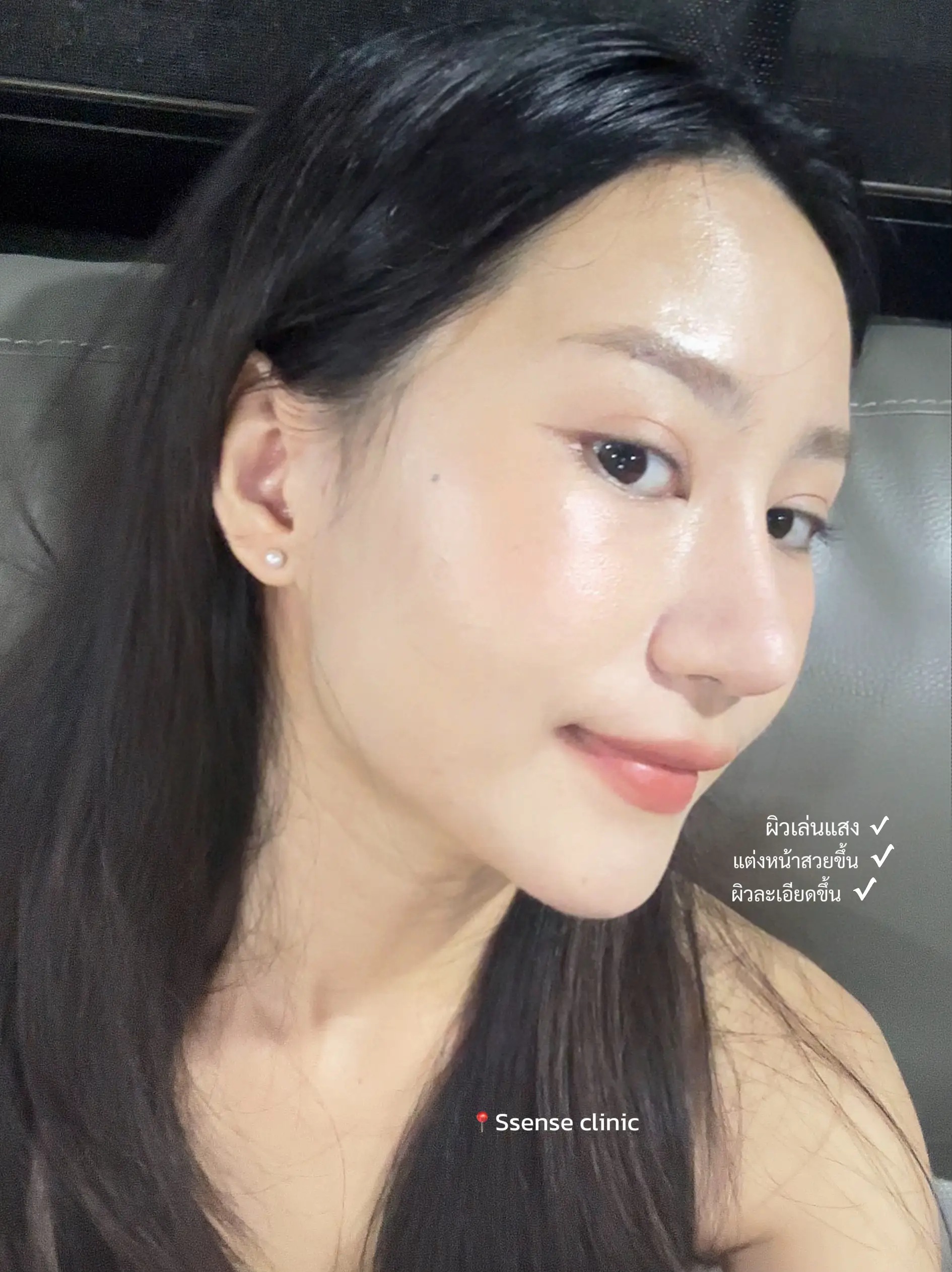 แชร์ประสบการณ์💉 ฉีดหน้าฉ่ำโกลว์ เห็นผลเร็วมาก | แกลเลอรีที่โพสต์โดย Bai por | Lemon8