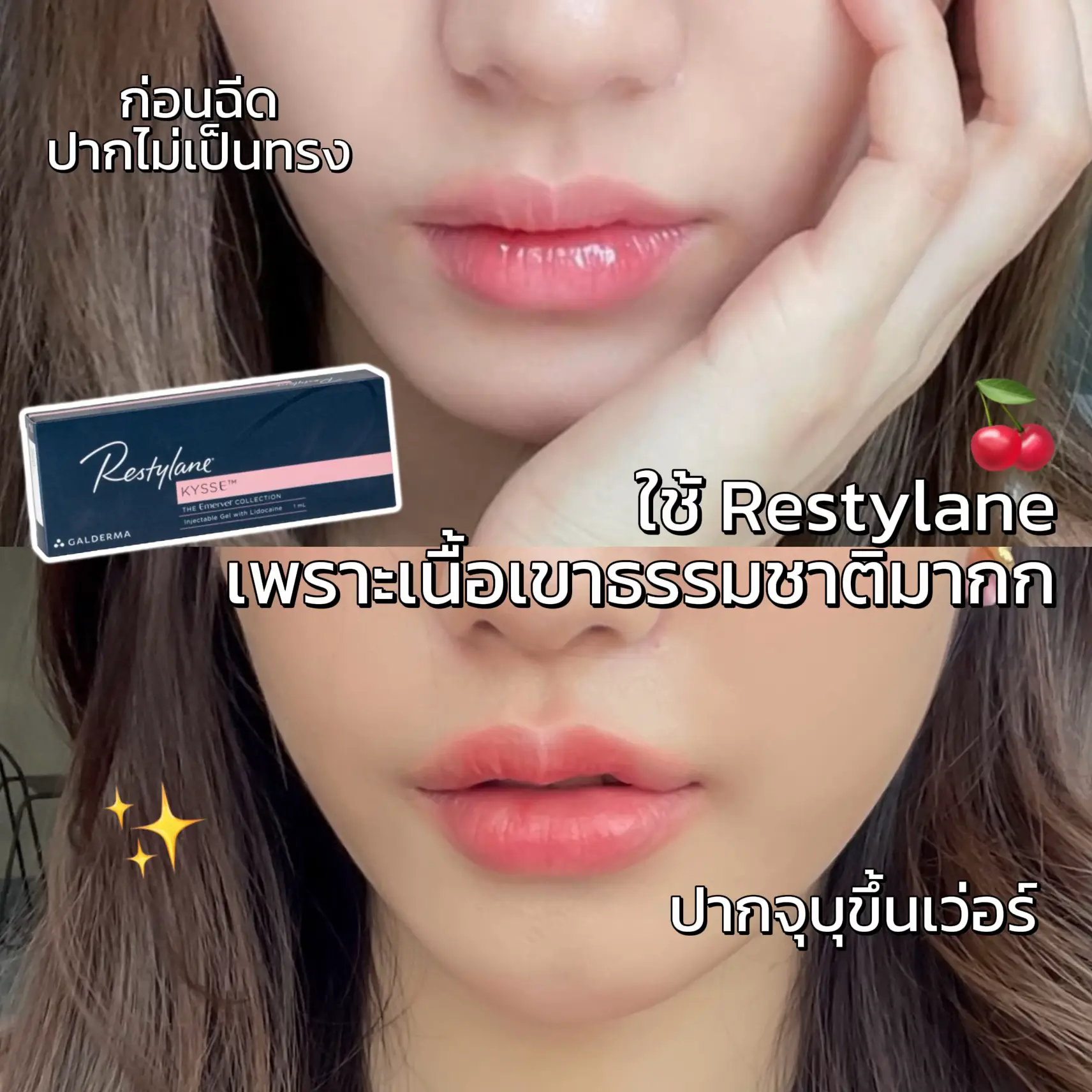 🍒 ฉีดปากครั้งแรกเลือก Restylane เลย 💕 | แกลเลอรีที่โพสต์โดย ฮลม.ชอบ ...