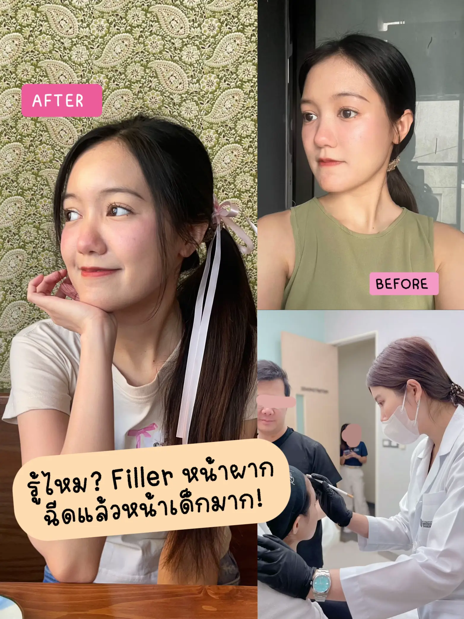 รู้ไหม Filler หน้าผากฉีดแล้วหน้าเด็กมาก! | แกลเลอรีที่โพสต์โดย Som Som | Lemon8