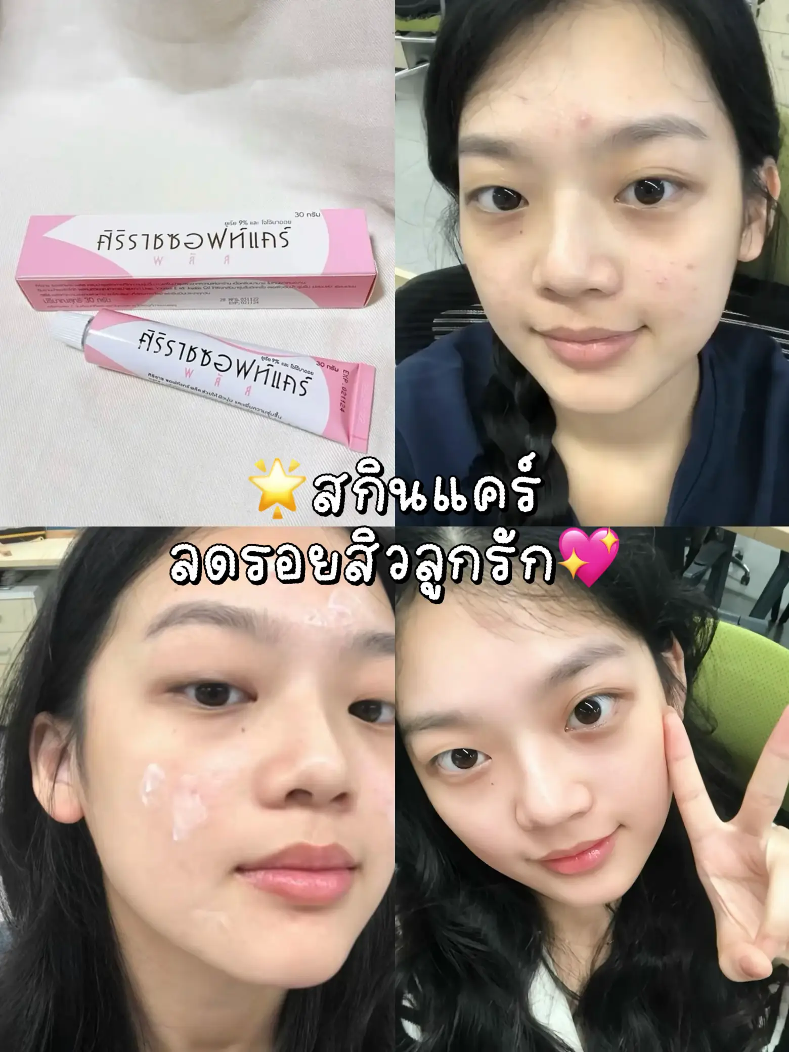 🌟สกินแคร์ลดรอยสิวลูกรัก💖 | แกลเลอรีที่โพสต์โดย 𝓜𝓪𝔂𝔃𝓪♡ | Lemon8