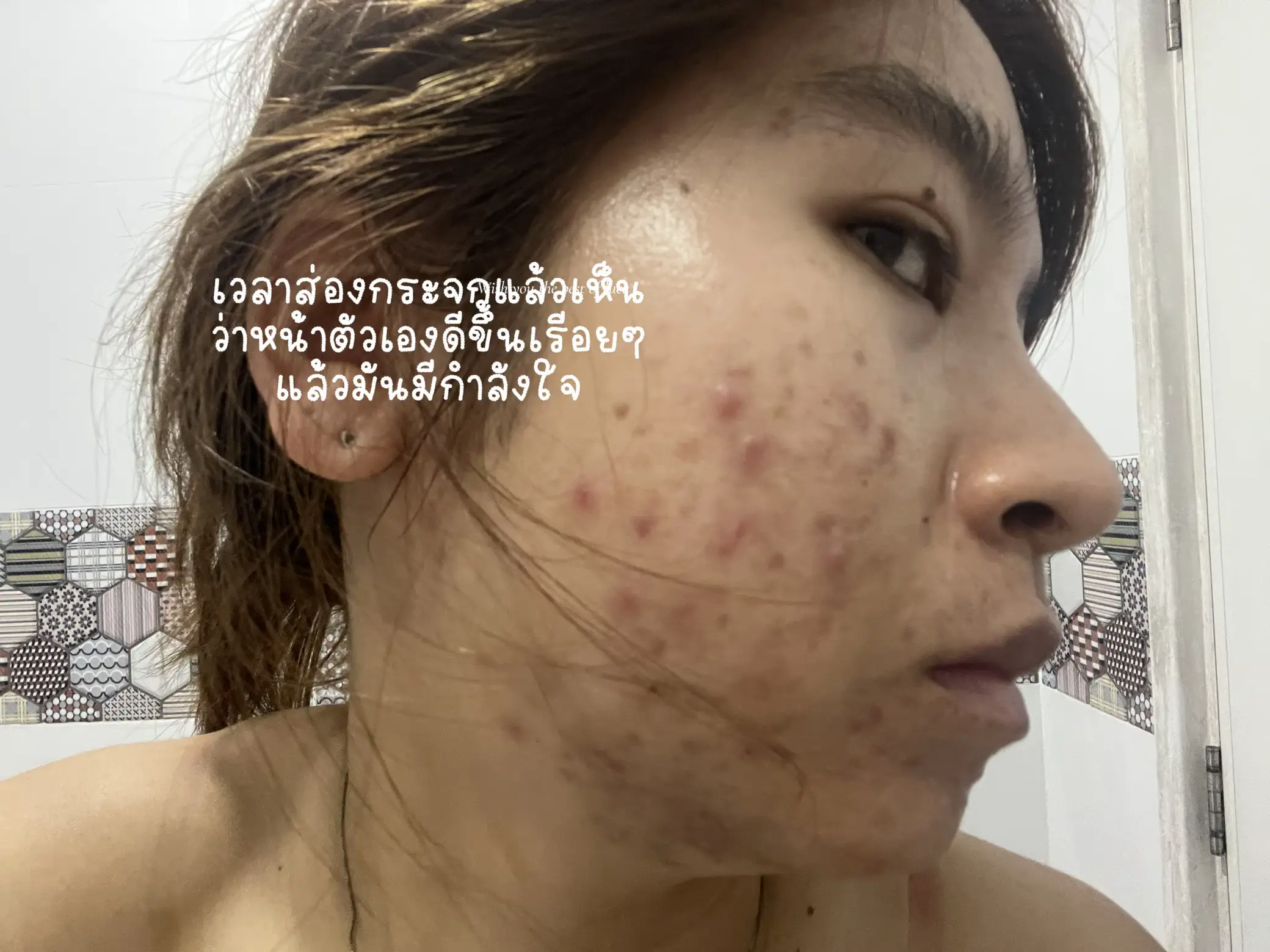 Review การใช้ Retinol แบบของแทร่ | แกลเลอรีที่โพสต์โดย ไม่กินหมู🐷 | Lemon8