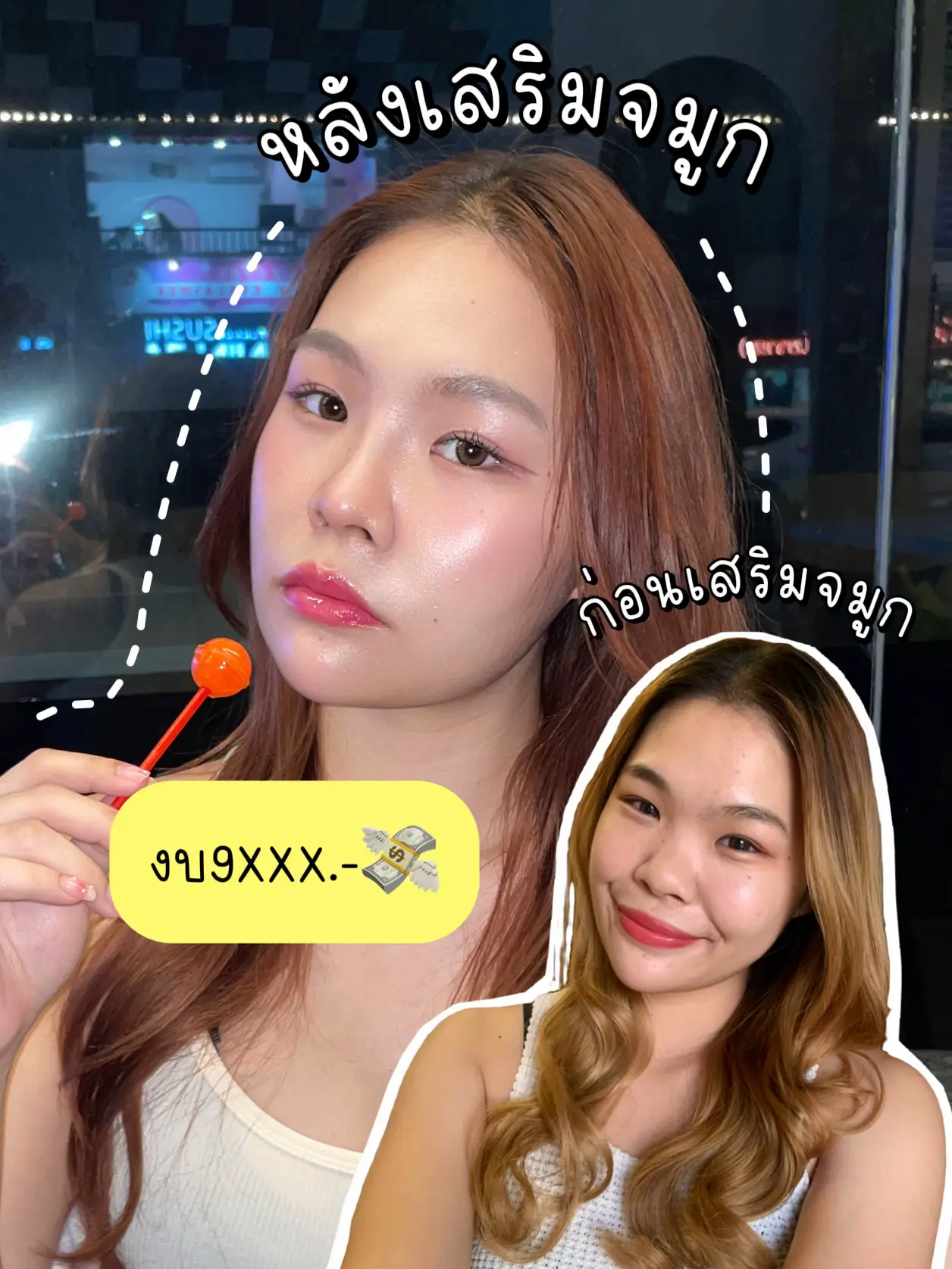 ก่อน-หลังเสริมจมูก |รู้งี้ทำนานแล้ว! งบ9xxx.- | แกลเลอรีที่โพสต์โดย Ployy_pwnii | Lemon8