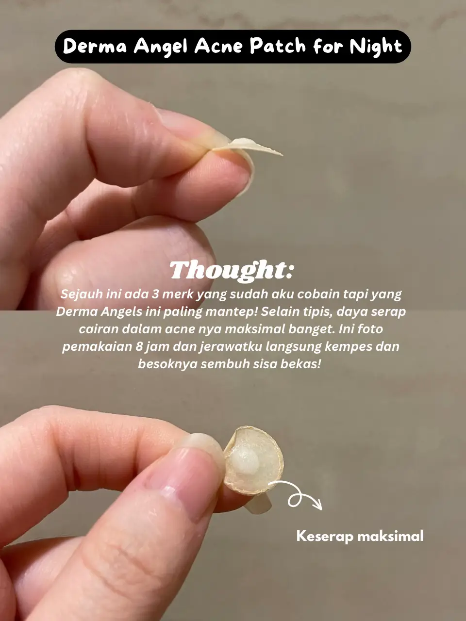 Acne Patch Yang Beneran Nampol! | Galeri diposting oleh arin | Lemon8