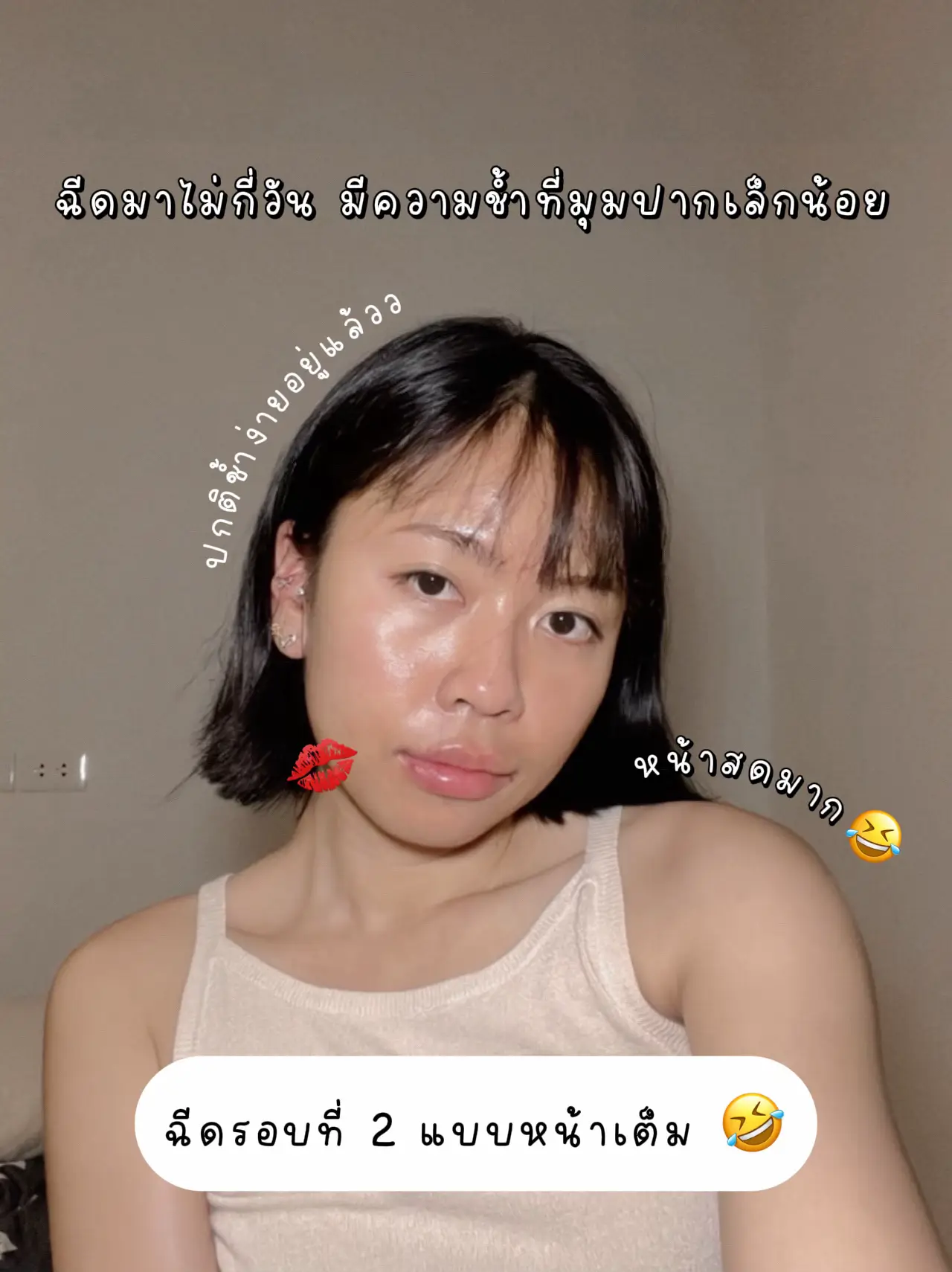 ฟิลเลอร์ปากทั้ง 2 รอบ ที่ธรรมดาคลินิก | แกลเลอรีที่โพสต์โดย toffy 🍬🍭 | Lemon8