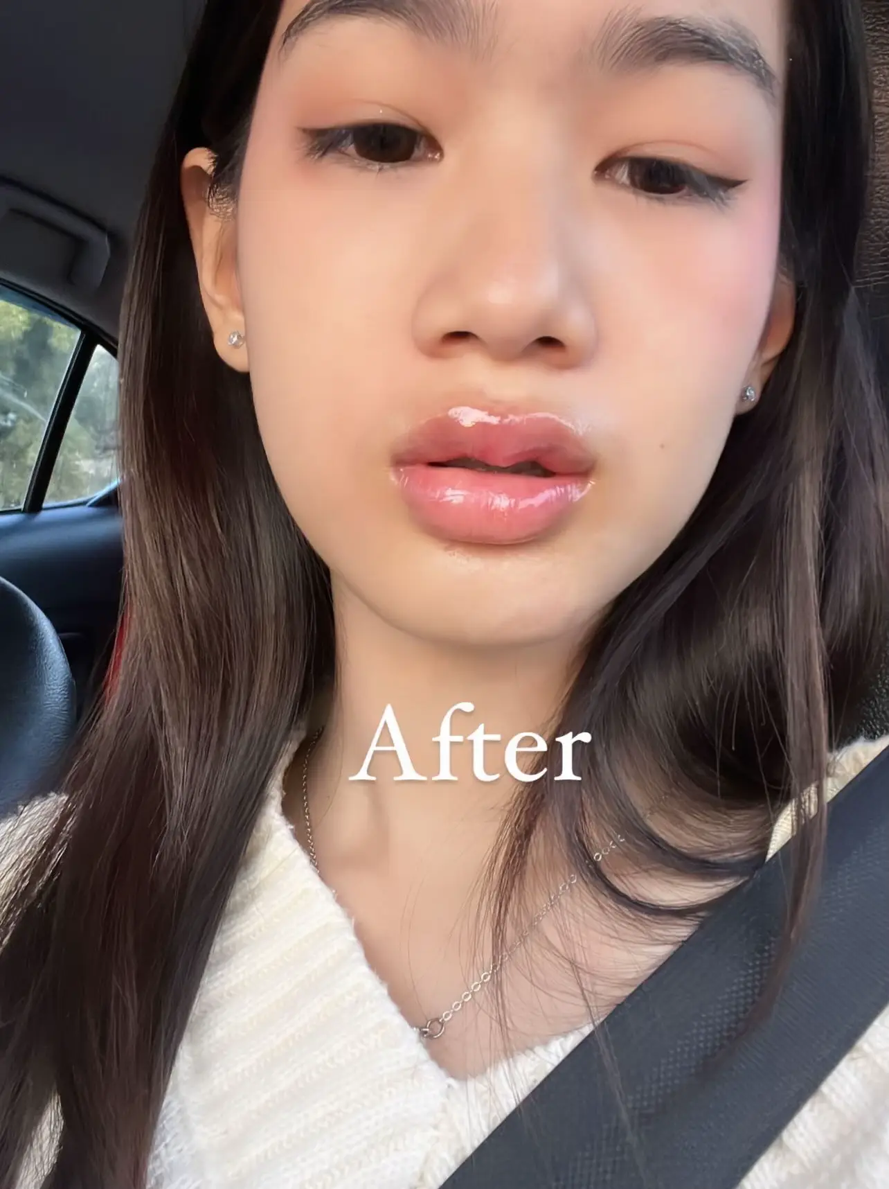 ฉีดปากครั้งแรก เจ็บมาก!😭 | แกลเลอรีที่โพสต์โดย Fern | Lemon8