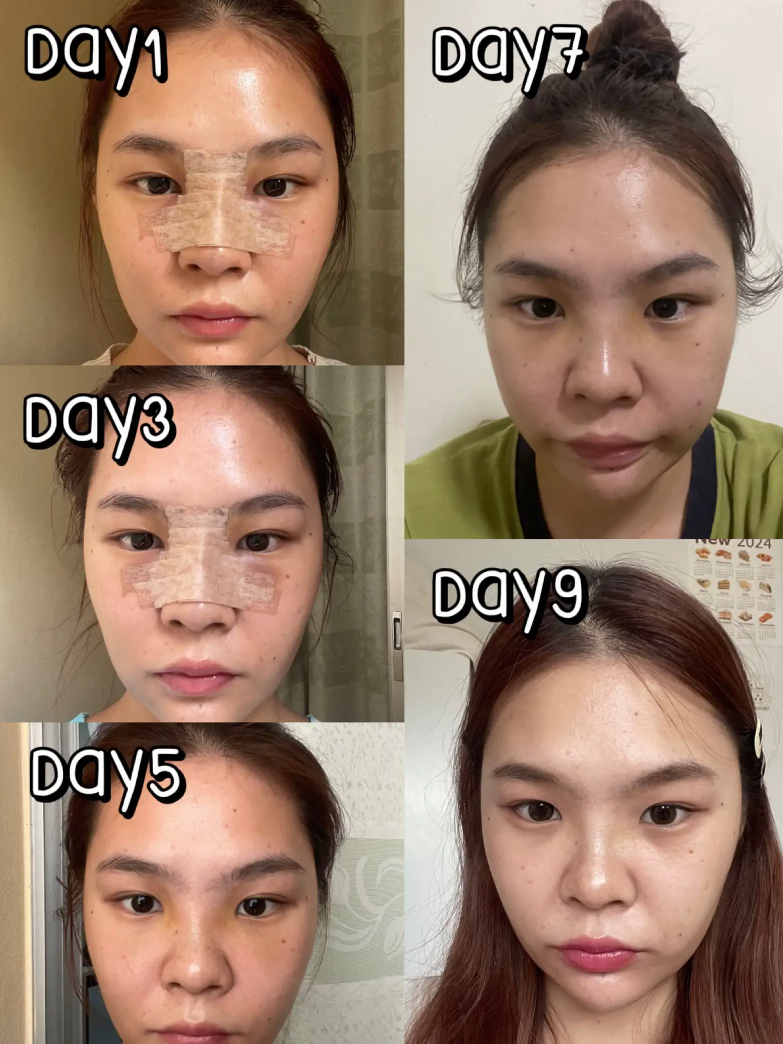 ก่อน-หลังเสริมจมูก |รู้งี้ทำนานแล้ว! งบ9xxx.- | แกลเลอรีที่โพสต์โดย ...