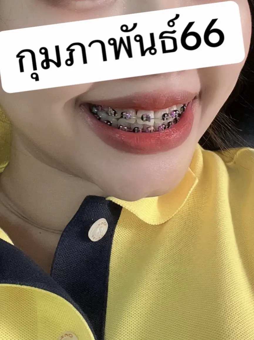 รีวิวจัดฟัน @ศาลายา นครปฐม | แกลเลอรีที่โพสต์โดย Thitikarn Boo | Lemon8