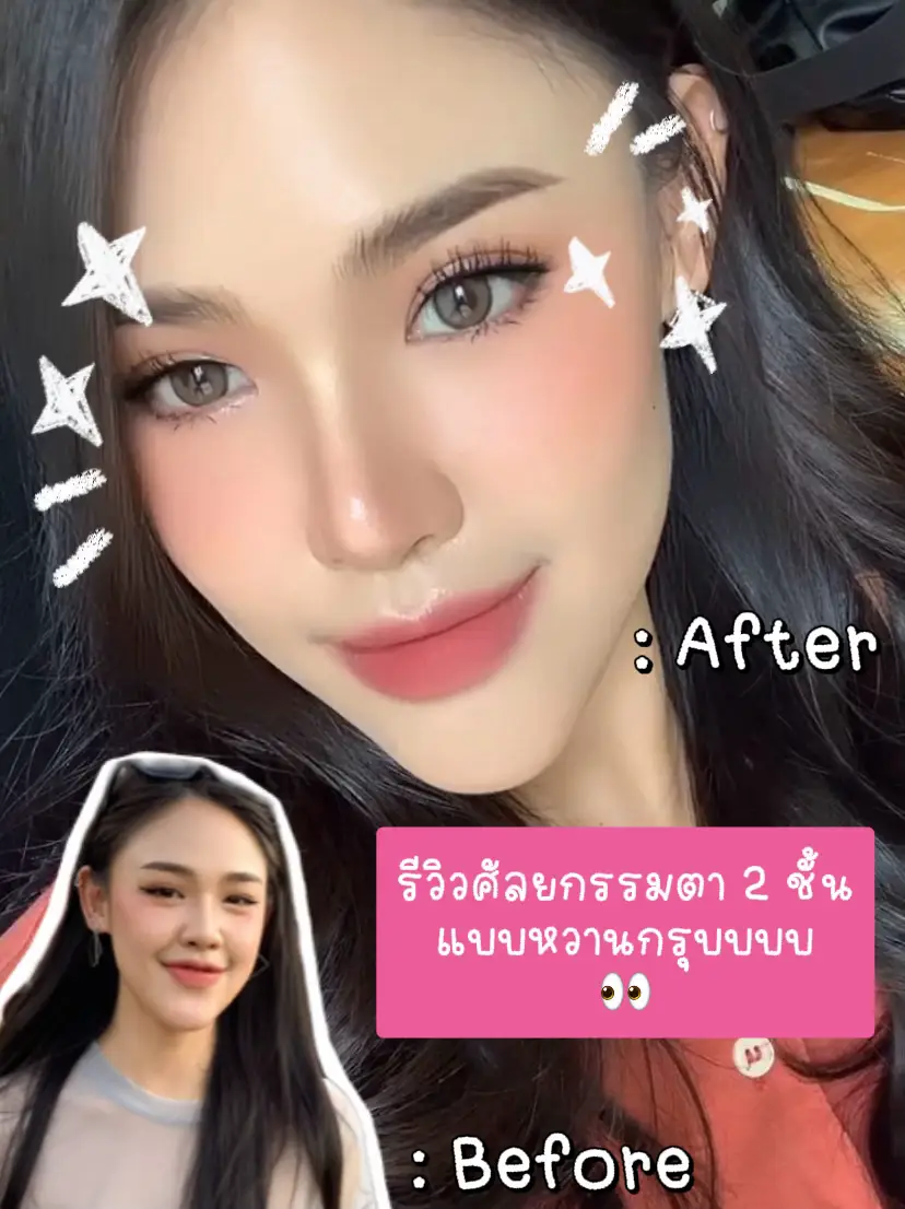 รีวิวศัลยกรรมตา 2 ชั้นแบบหวานกรุบ 👀 แกลเลอรีที่โพสต์โดย Mymild Lemon8