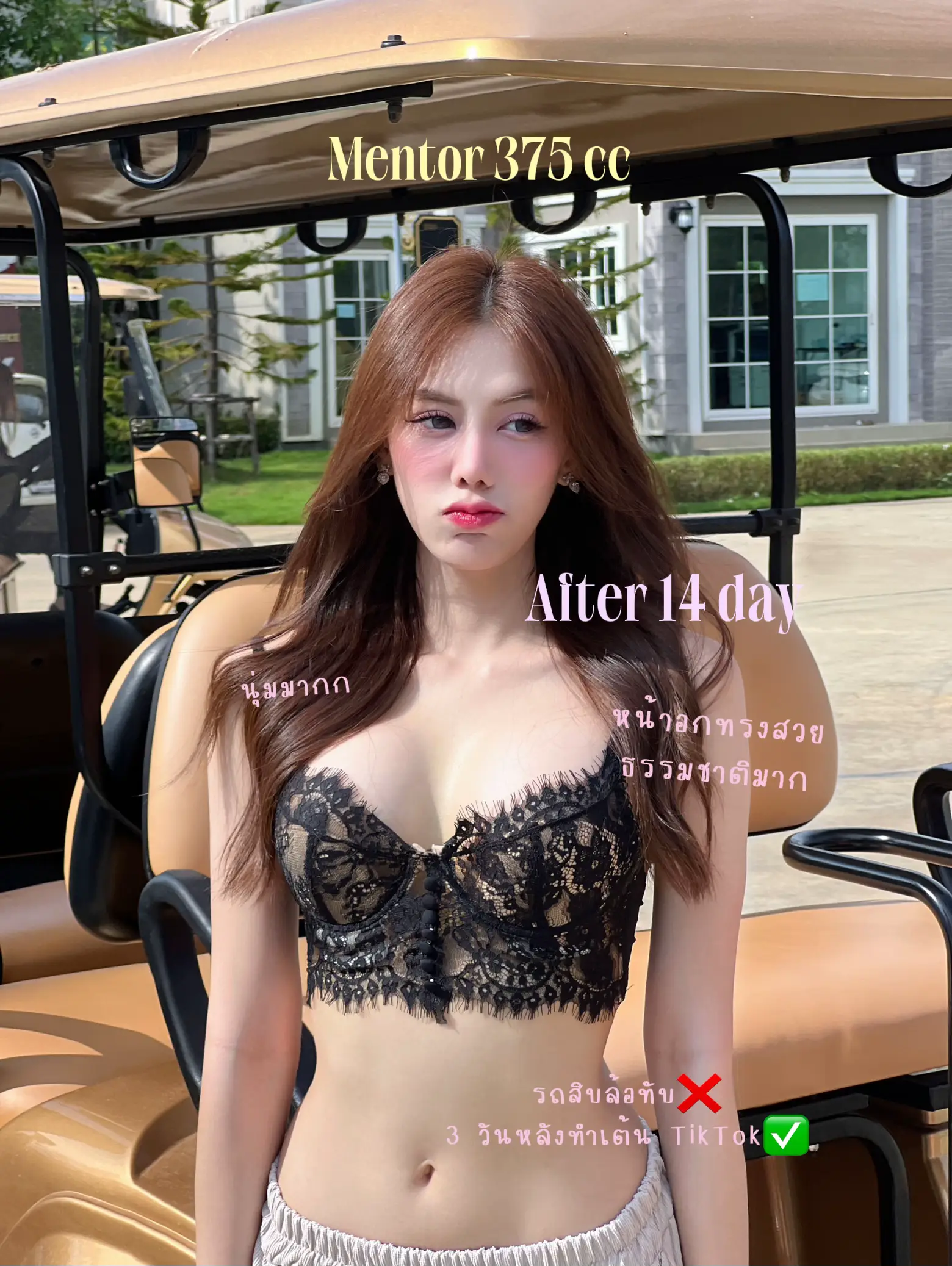 รีวิวเสริมหน้าอกครั้งแรกในชีวิต🎀💕 | แกลเลอรีที่โพสต์โดย Muham | Lemon8