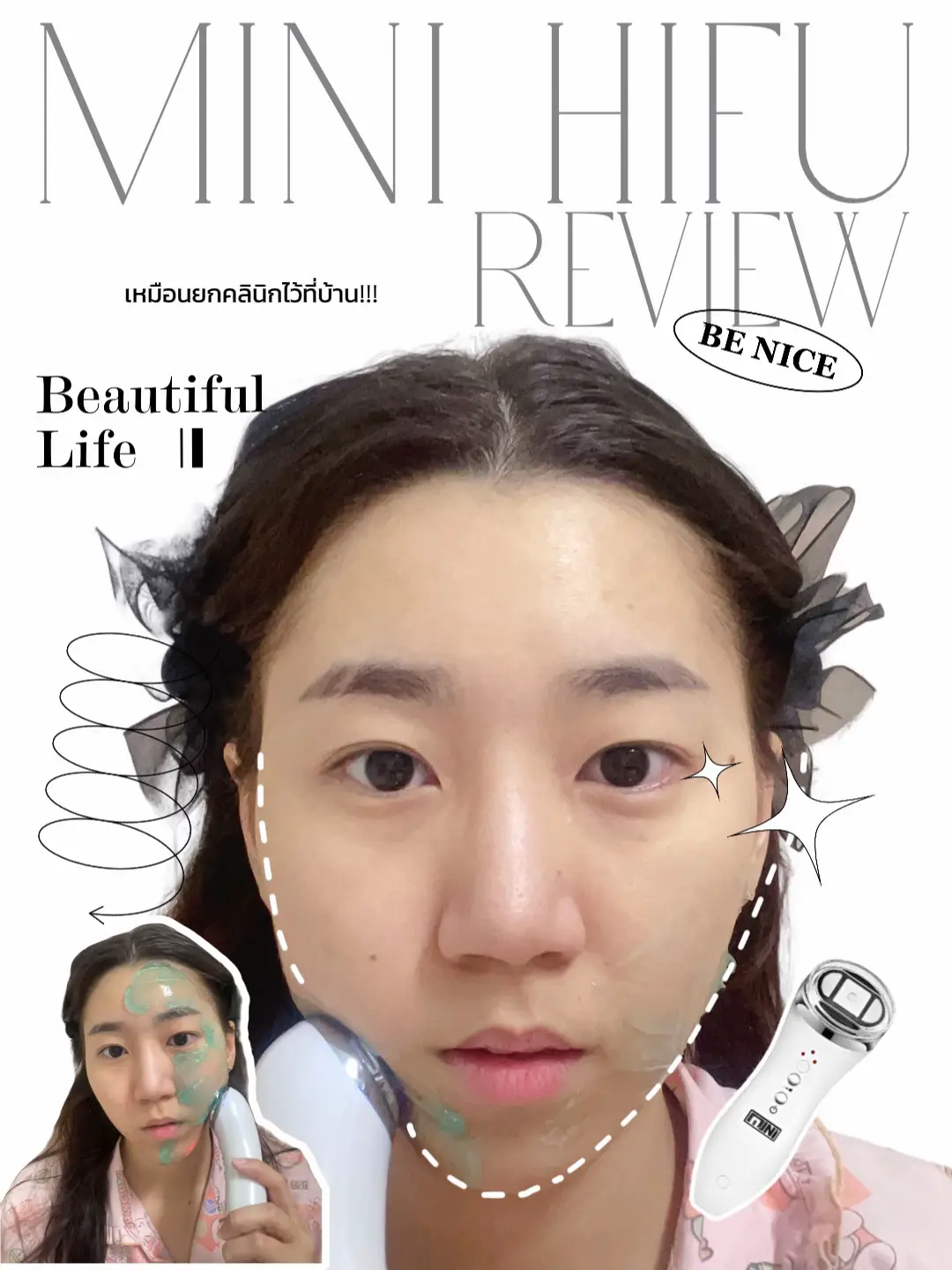 Premium Hifu สองแบ้งค์เทามีทอน เห็นผลจริง😱😱 | แกลเลอรีที่โพสต์โดย ตอเต่าป้ายยา💋👊🏻 | Lemon8