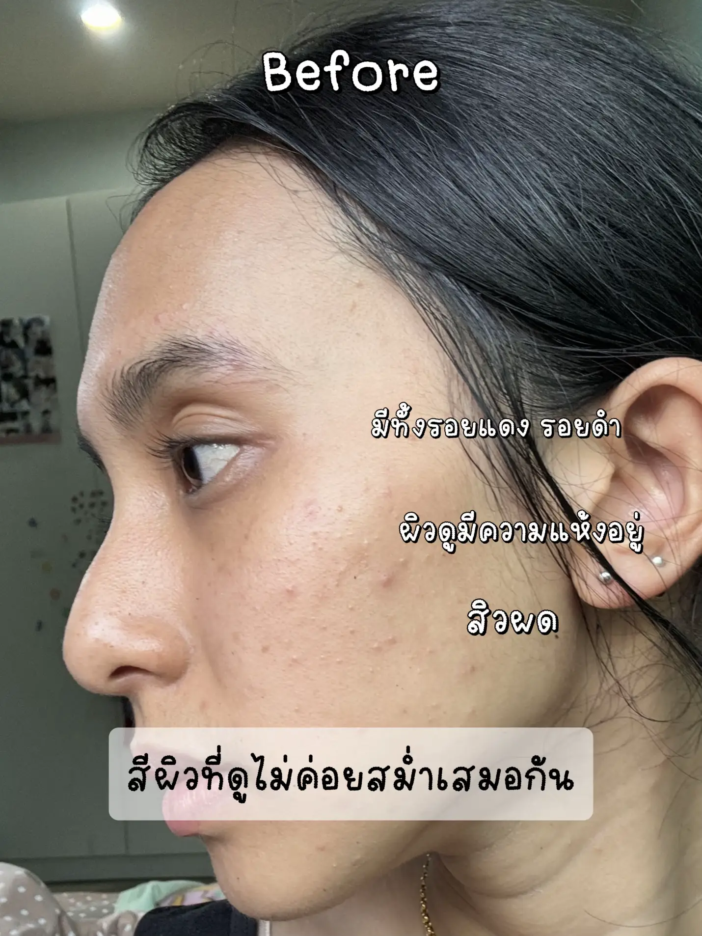 Dark Spot377 กู้หน้าจากรอยสิ้ว และผิวโทรม🤎 | แกลเลอรีที่โพสต์โดย ma.mamind | Lemon8