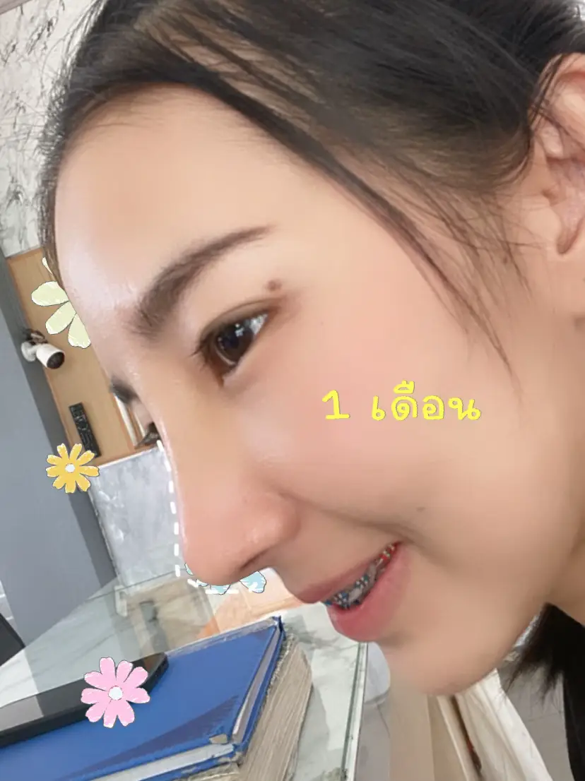 รีวิวศัลยกรรมครั้งแรก ฉบับคนเนื้อน้อย | แกลเลอรีที่โพสต์โดย Popla 🐳 | Lemon8