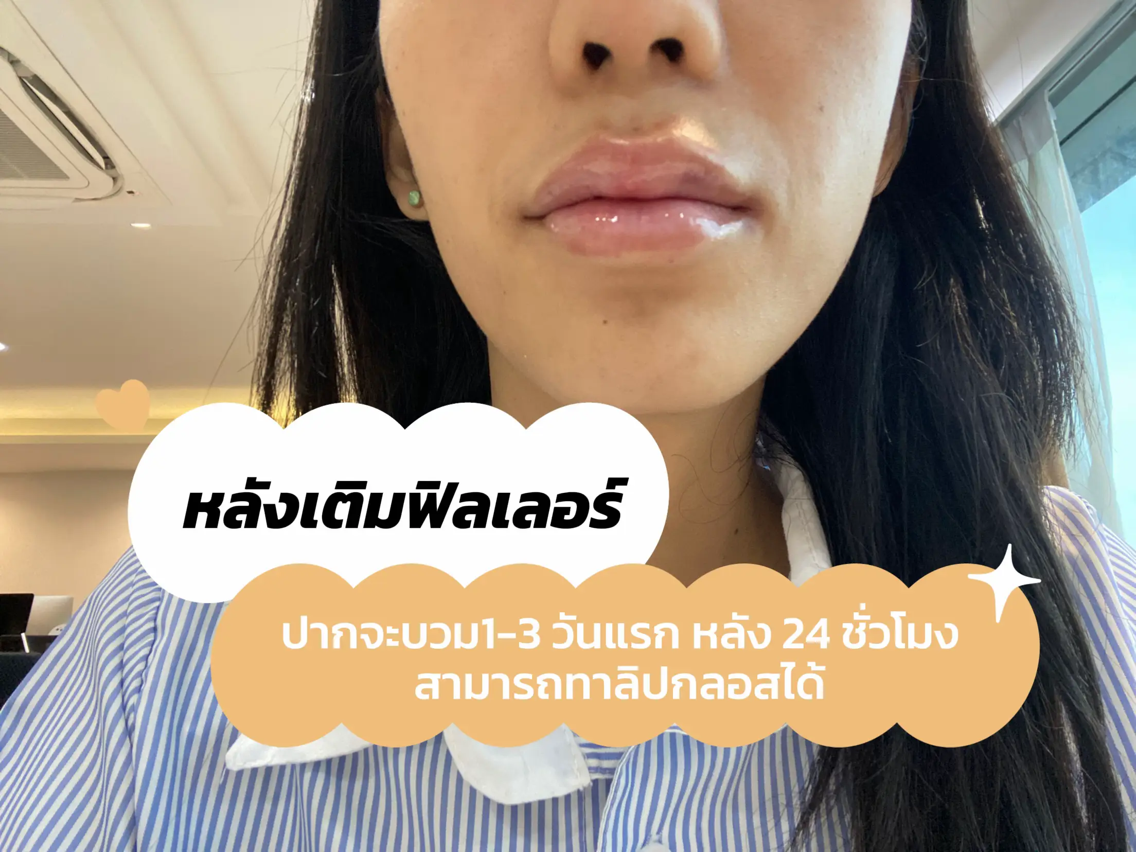 Say goodbye to the "thin mouth" problem. Fill in the filler helps. | Gallery posted by Magazine ...