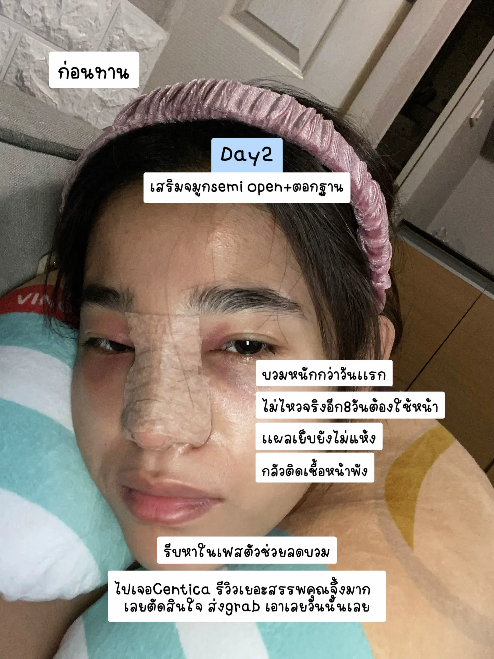 ลดบวม Proctase-P คือ ยา แก้ อะไร - การค้นหาใน Lemon8