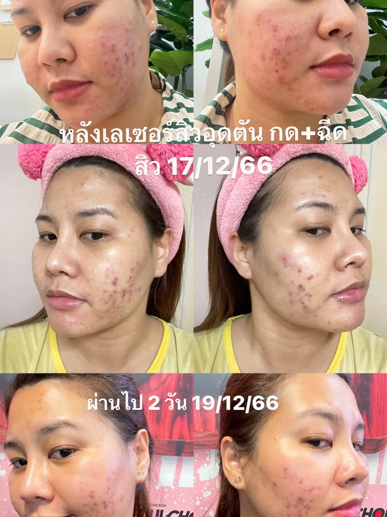 Ep.1. รักษาสิวครั้งแรก @พรเกษมคลีนิค | แกลเลอรีที่โพสต์โดย Mm.mee NRKL | Lemon8