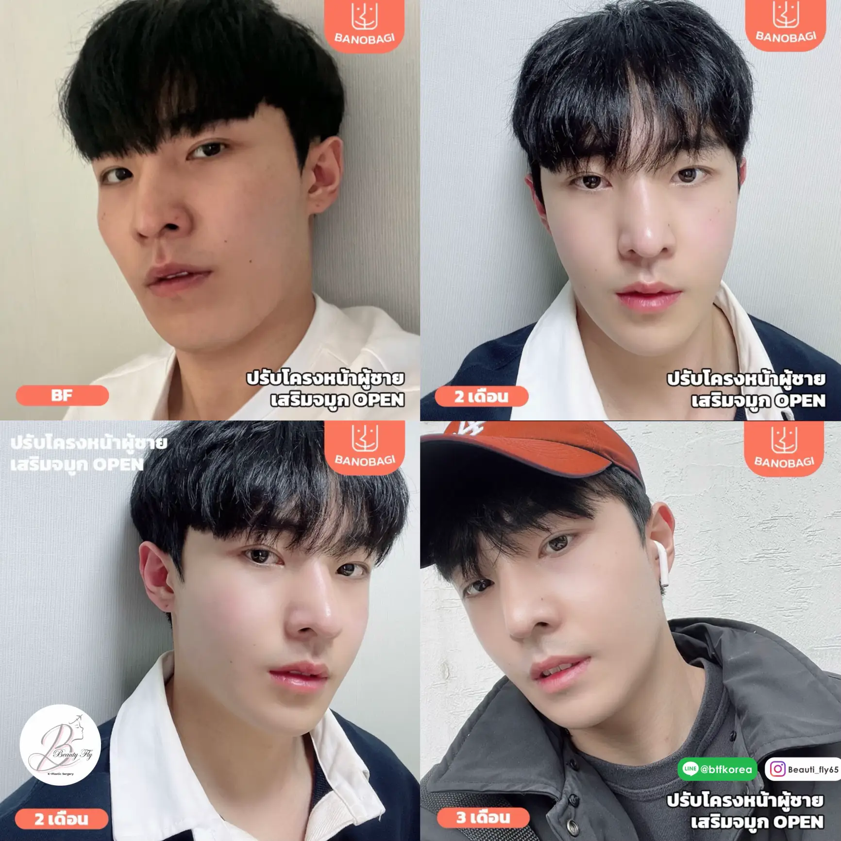 ศัลยกรรมผู้ชาย | แกลเลอรีที่โพสต์โดย Noom BTF | Lemon8