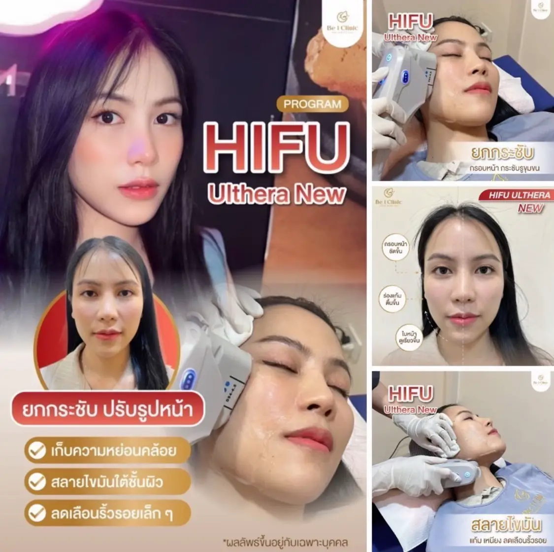 โปรแกรม hifu ยกกระชับแก้มเหนียง | แกลเลอรีที่โพสต์โดย Be1clinic | Lemon8