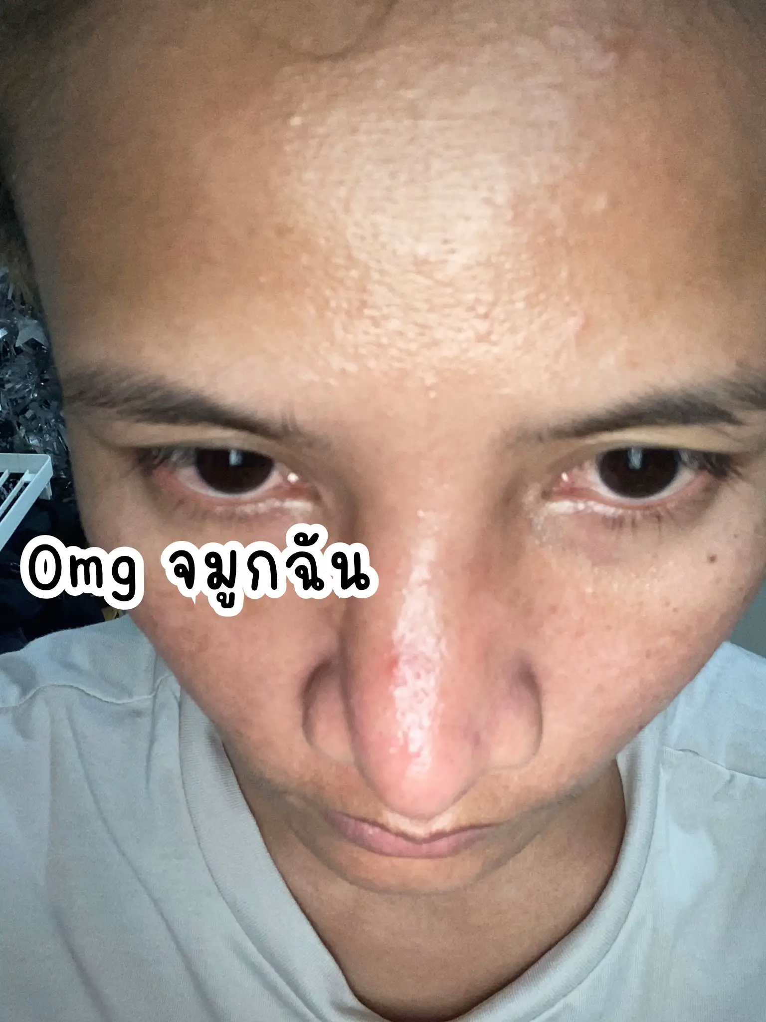 ลดบวม Proctase-P คือ ยา แก้ อะไร - การค้นหาใน Lemon8