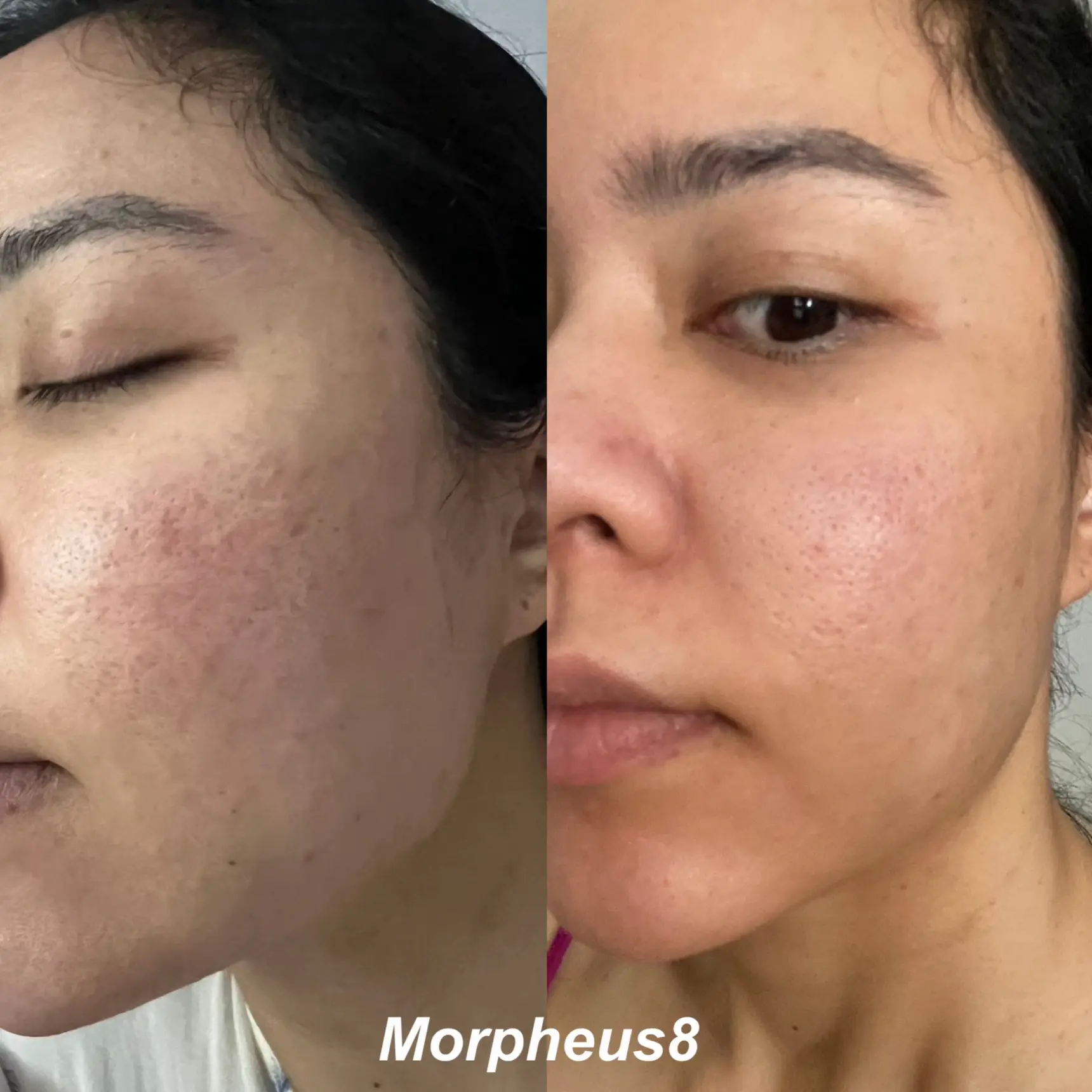 Sylfirm X and Morpheus Reviews Which Hurts More? | Gallery posted by hotmadame 👄 | Lemon8