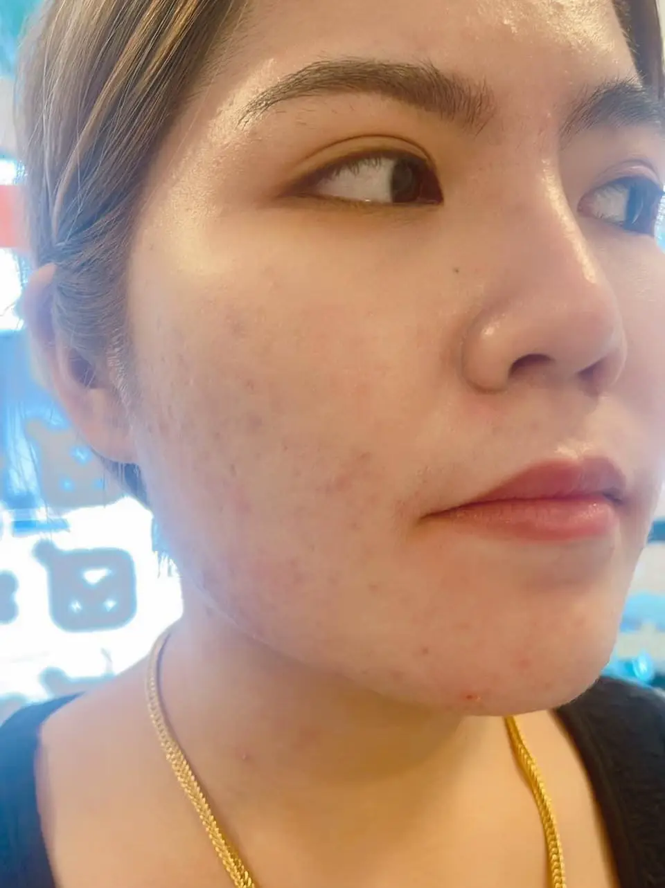 รักษาสิว อายตานิค | แกลเลอรีที่โพสต์โดย Tong | Lemon8