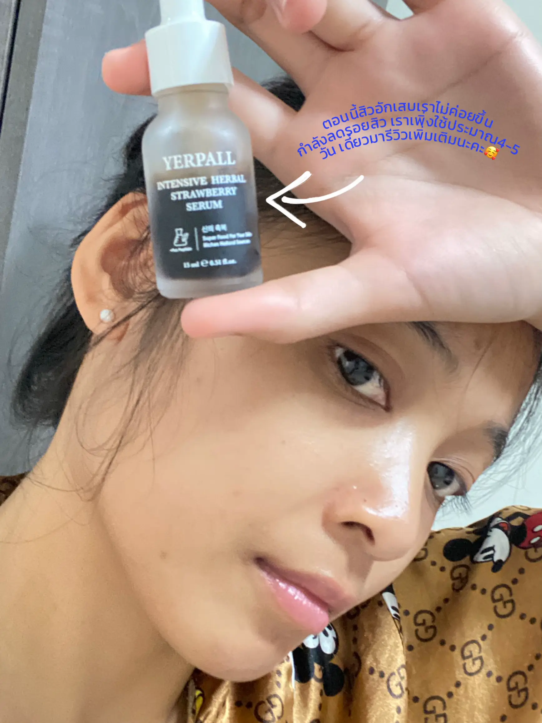 สกิลแคร์รักษาสิวงบหลักร้อย | แกลเลอรีที่โพสต์โดย Mod_luckkana