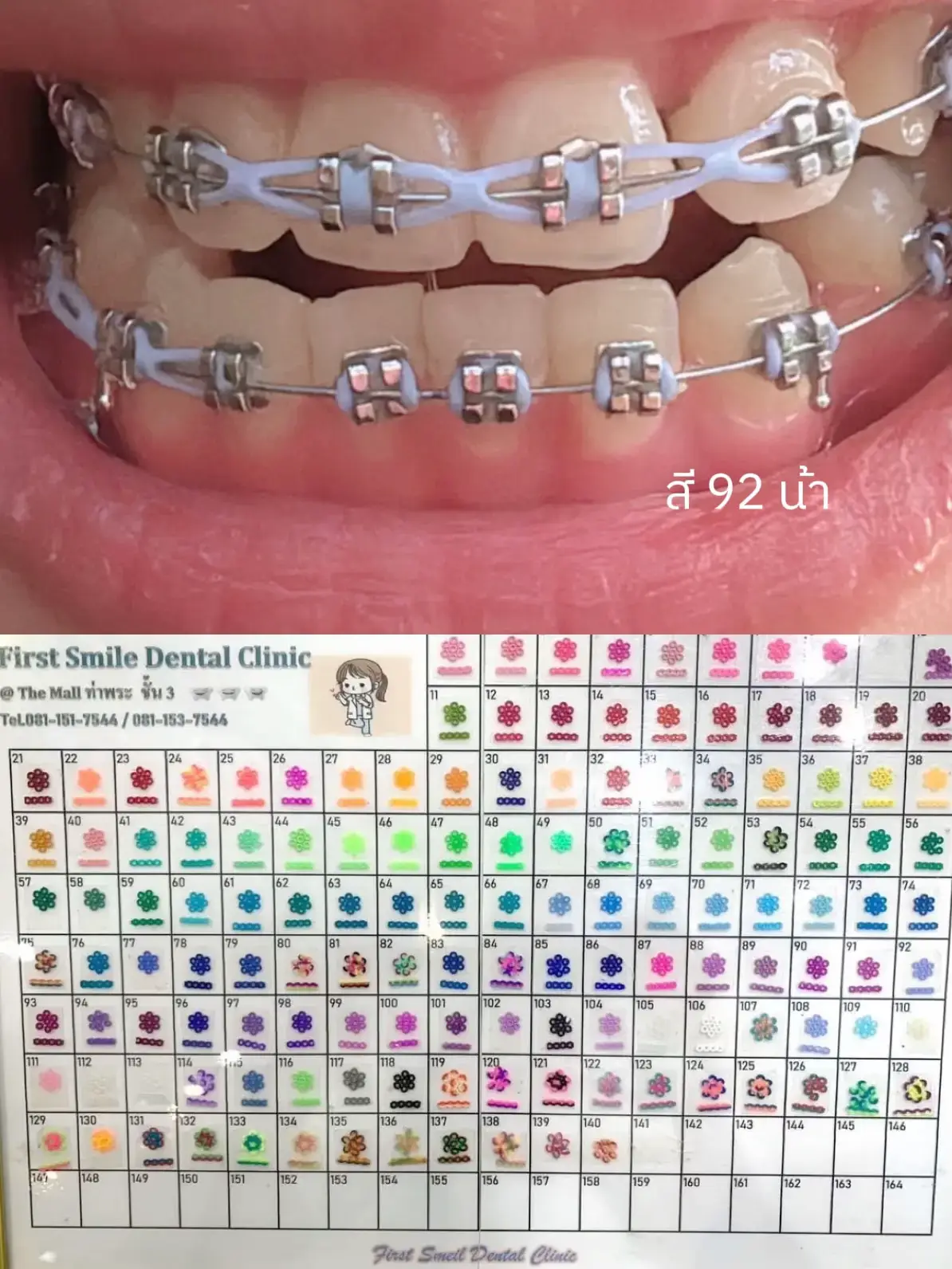 อย่างปวดเลยคุนน้า 🤣🥲 เชนบนมาละจ้า คนจัดฟันจะรู้ดีย์~~ 💗 | แกลเลอรีที่โพสต์โดย ᪤𓈒 meowmatcha | Lemon8