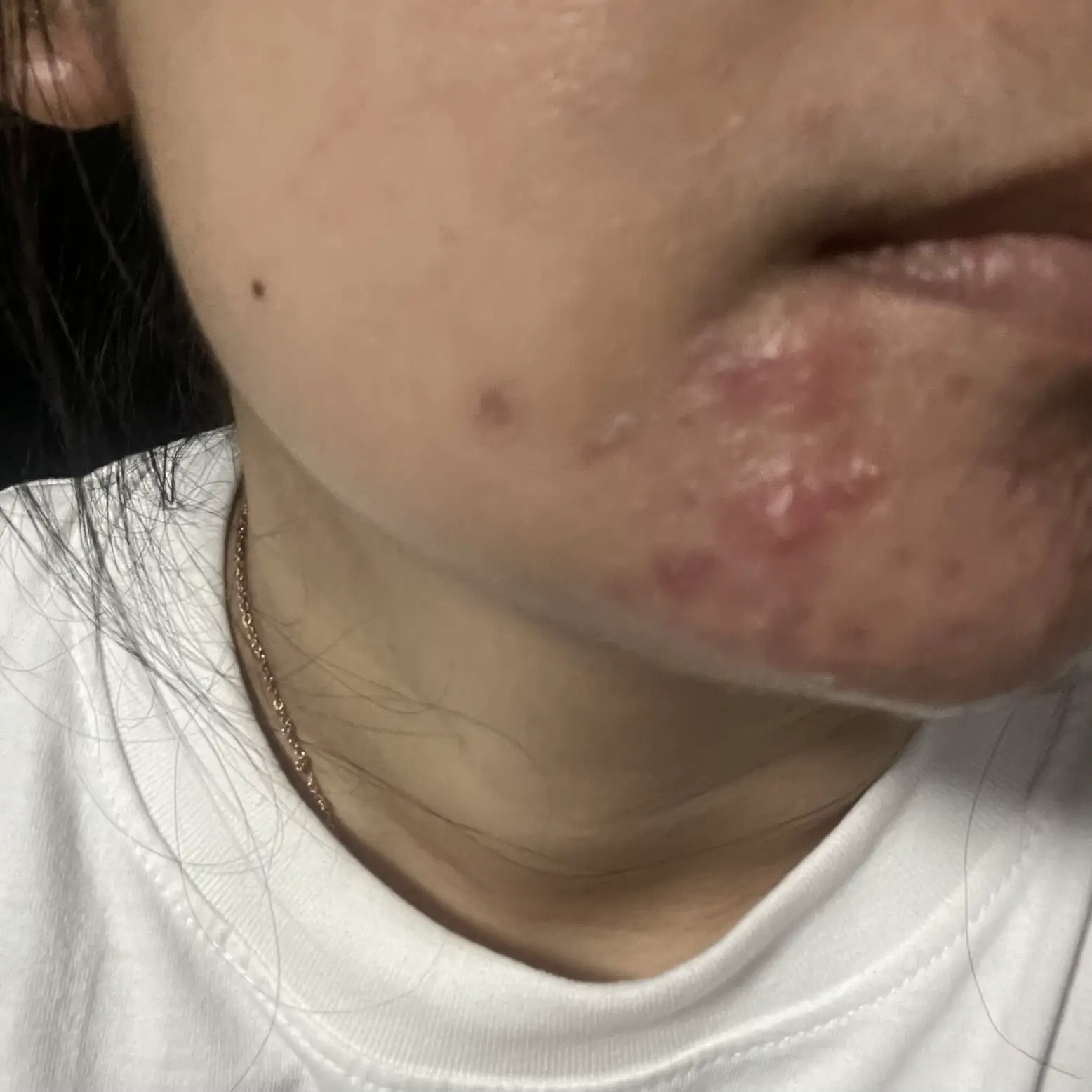 #ช่วยด้วยค่ะสิวแบบนี้รักษายังไงดี | แกลเลอรีที่โพสต์โดย phcrpn_beau ...