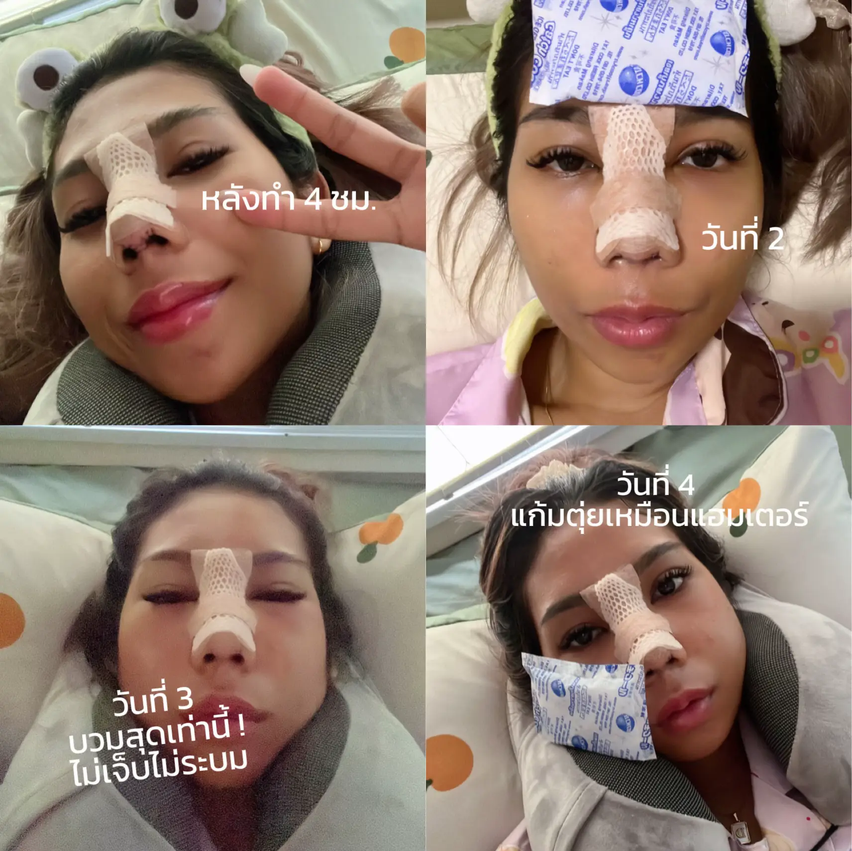แก้จมูกครั้งที่ 3 ! 🍋 | แกลเลอรีที่โพสต์โดย DOUBLE D ; ♡ 94 | Lemon8