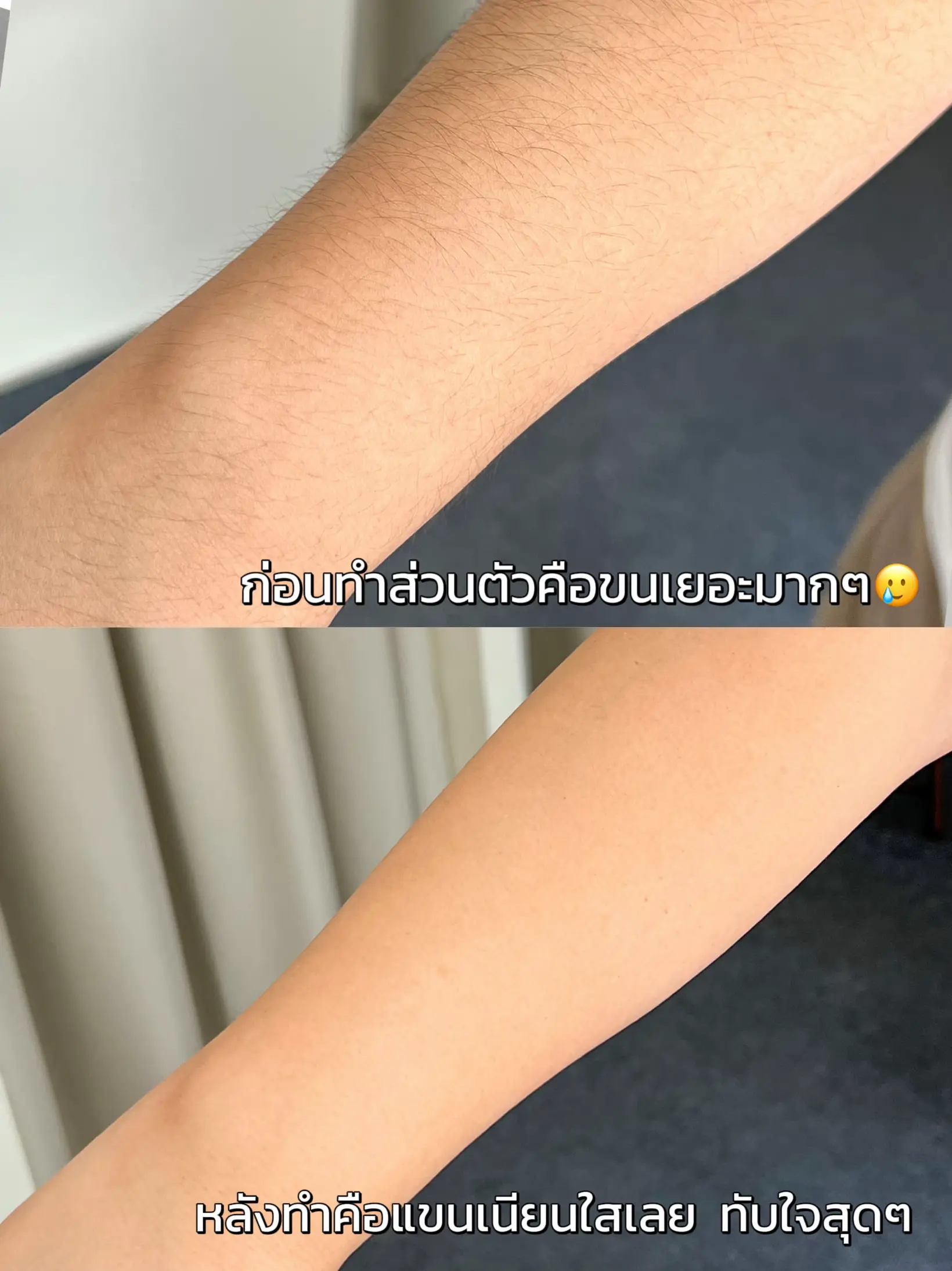 ⚡The first arm hair laser review changed the monkey to the barrier.🐒💖 ...