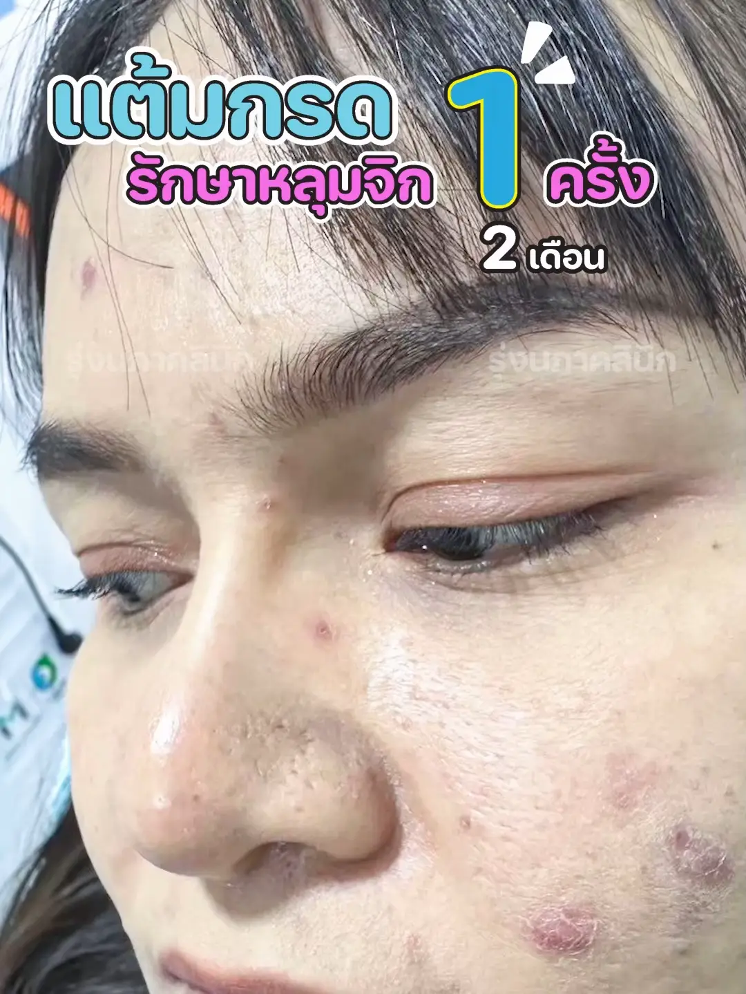 แต้มกรด รักษาหลุมจิก (เด่นจมูก) 1 ครั้ง | วิดีโอที่เผยแพร่โดย Dr.Ploy รุ่งนภา | Lemon8