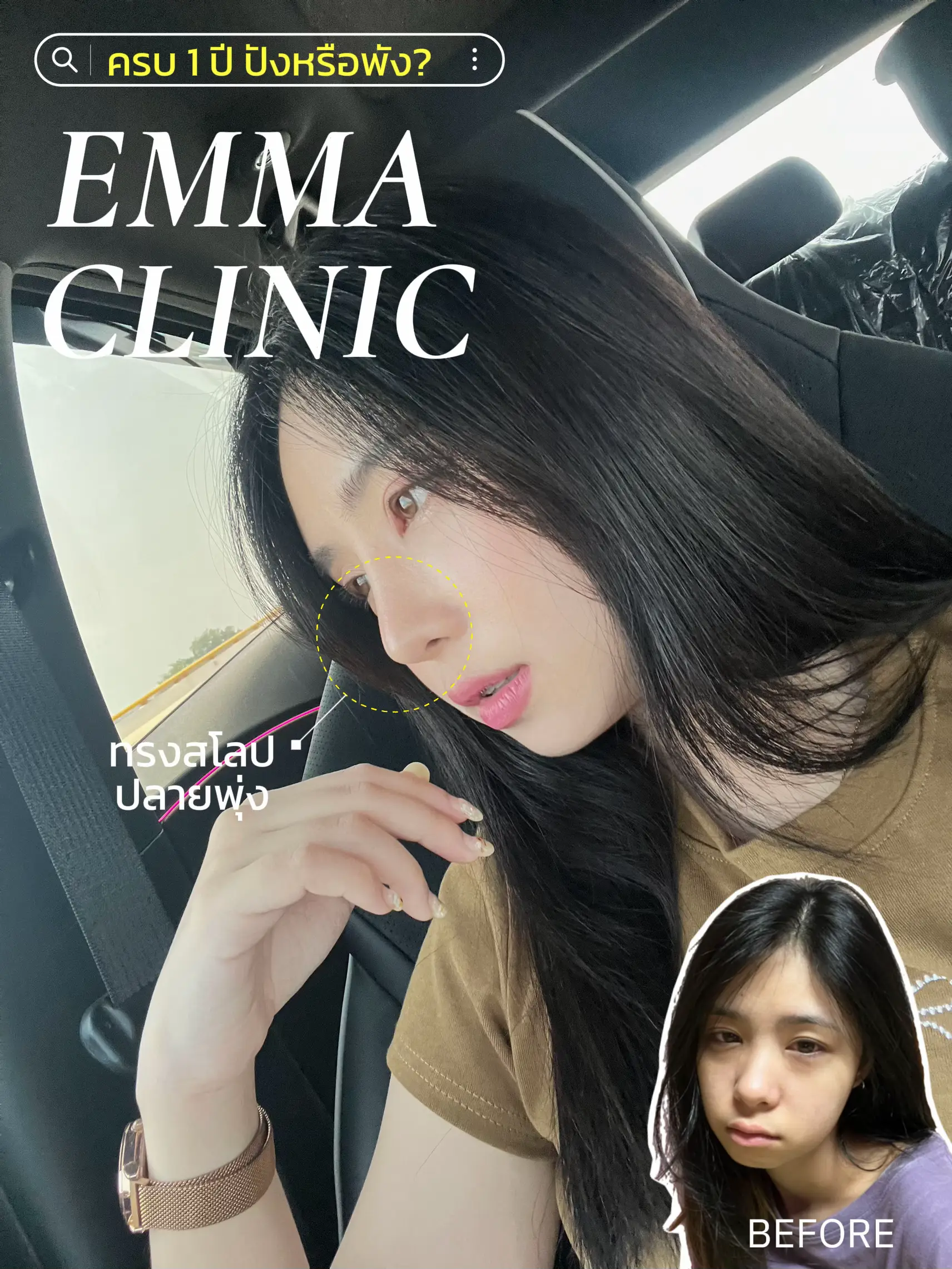 ครบ 1 ปีปังหรือพัง 💬 | EMMA CLINIC | แกลเลอรีที่โพสต์โดย ˚୨୧⋆aumcq ｡ | Lemon8