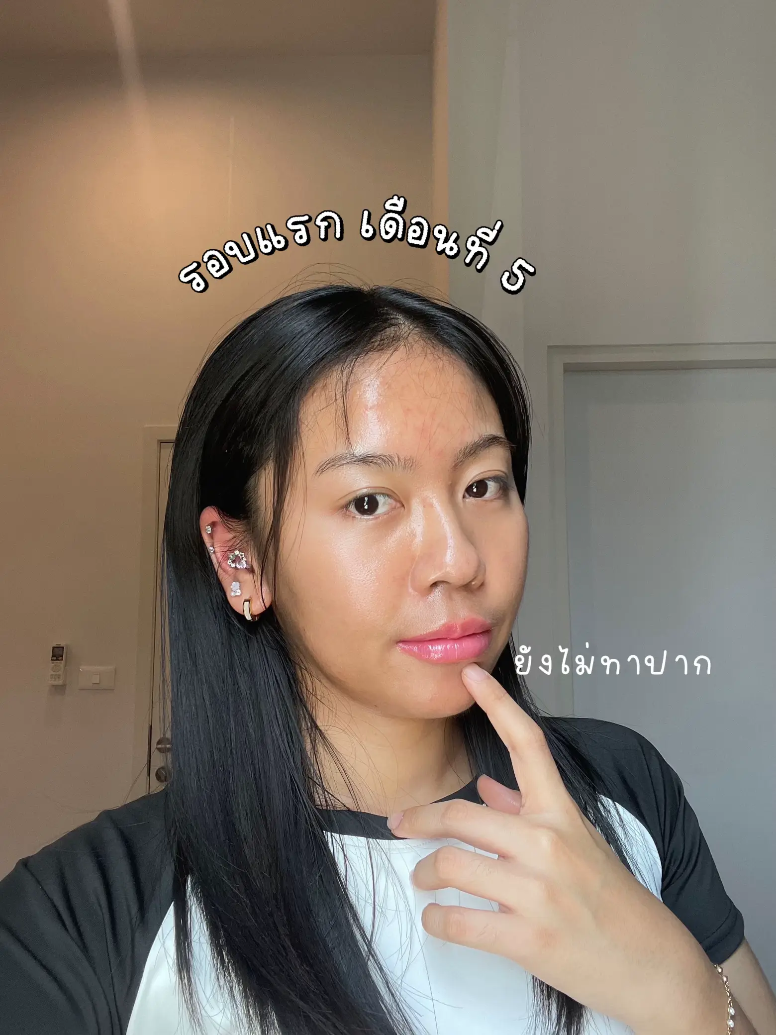 ฟิลเลอร์ปากทั้ง 2 รอบ ที่ธรรมดาคลินิก | แกลเลอรีที่โพสต์โดย toffy 🍬🍭 | Lemon8