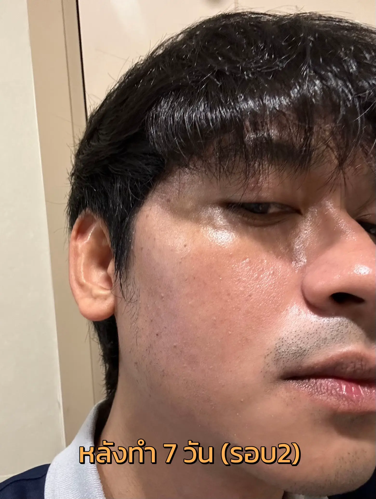 Review ทำ Pico ที่ Prime Aesthetics | แกลเลอรีที่โพสต์โดย Hello._.noon | Lemon8