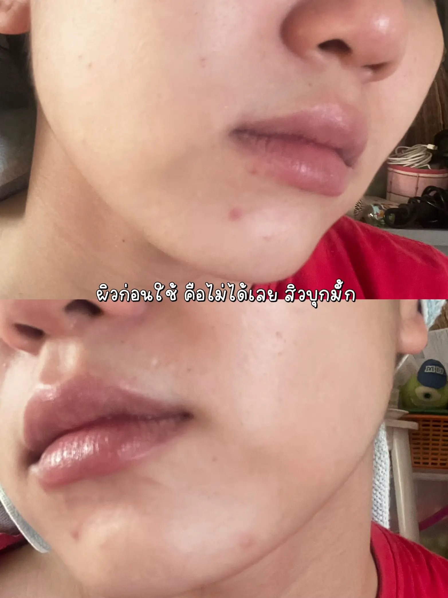 โทนเนอร์ฉบับคนเป็นสิว ต้องลอง 🫶🏻👀 | แกลเลอรีที่โพสต์โดย nisc.h | Lemon8