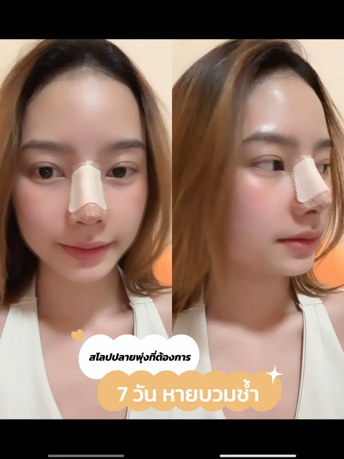 รีวิวเสริมจมูกแท่งแรก ขอปังทีเดียว📍 | แกลเลอรีที่โพสต์โดย Busaraptc | Lemon8