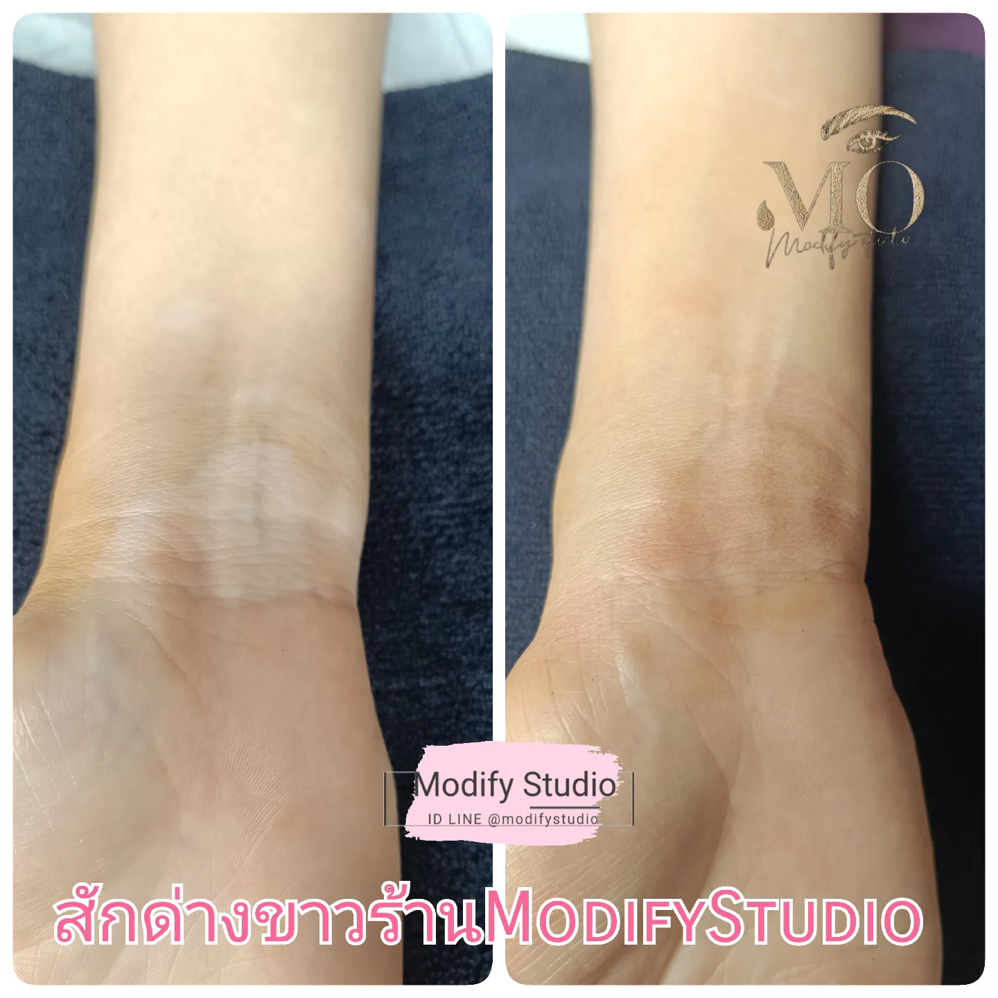 สักด่างขาว เพื่อการรักษา | แกลเลอรีที่โพสต์โดย Modify Studio | Lemon8