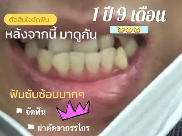 รีวิว😃 อายุใกล้ 40 จัดฟัน ยังทันไหม?? แล้วคอมเม้นท์ด้วยน๊าาา | แกลเลอรี ...