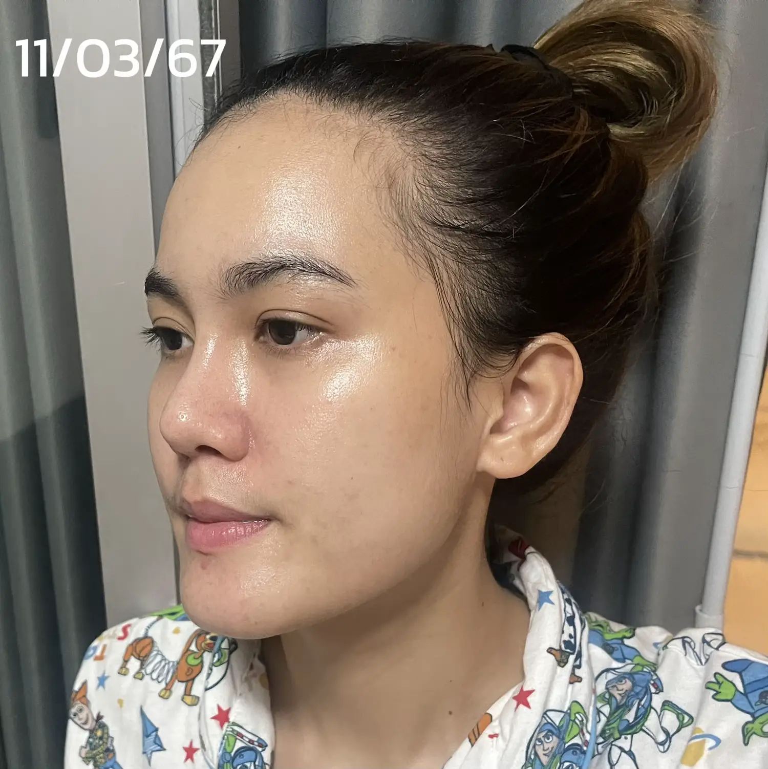 รักษาสิวเอง EP1 (แบบ100%) | แกลเลอรีที่โพสต์โดย Seryoung sp | Lemon8