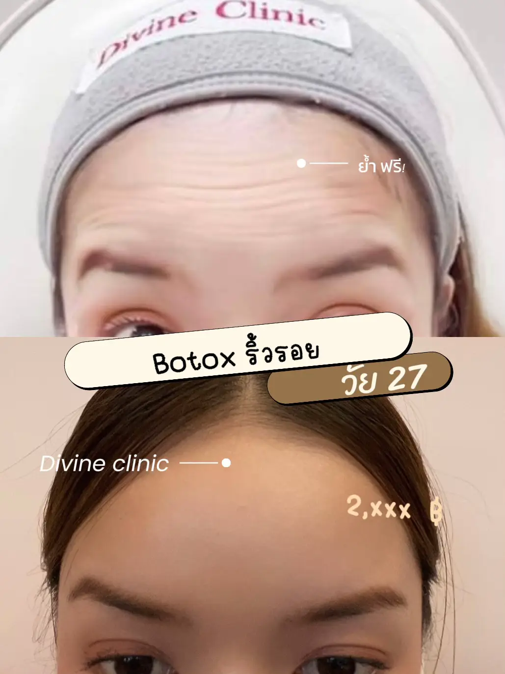 รีวิว Botox ริ้วรอย 💉 | แกลเลอรีที่โพสต์โดย Cartoonkyr | Lemon8