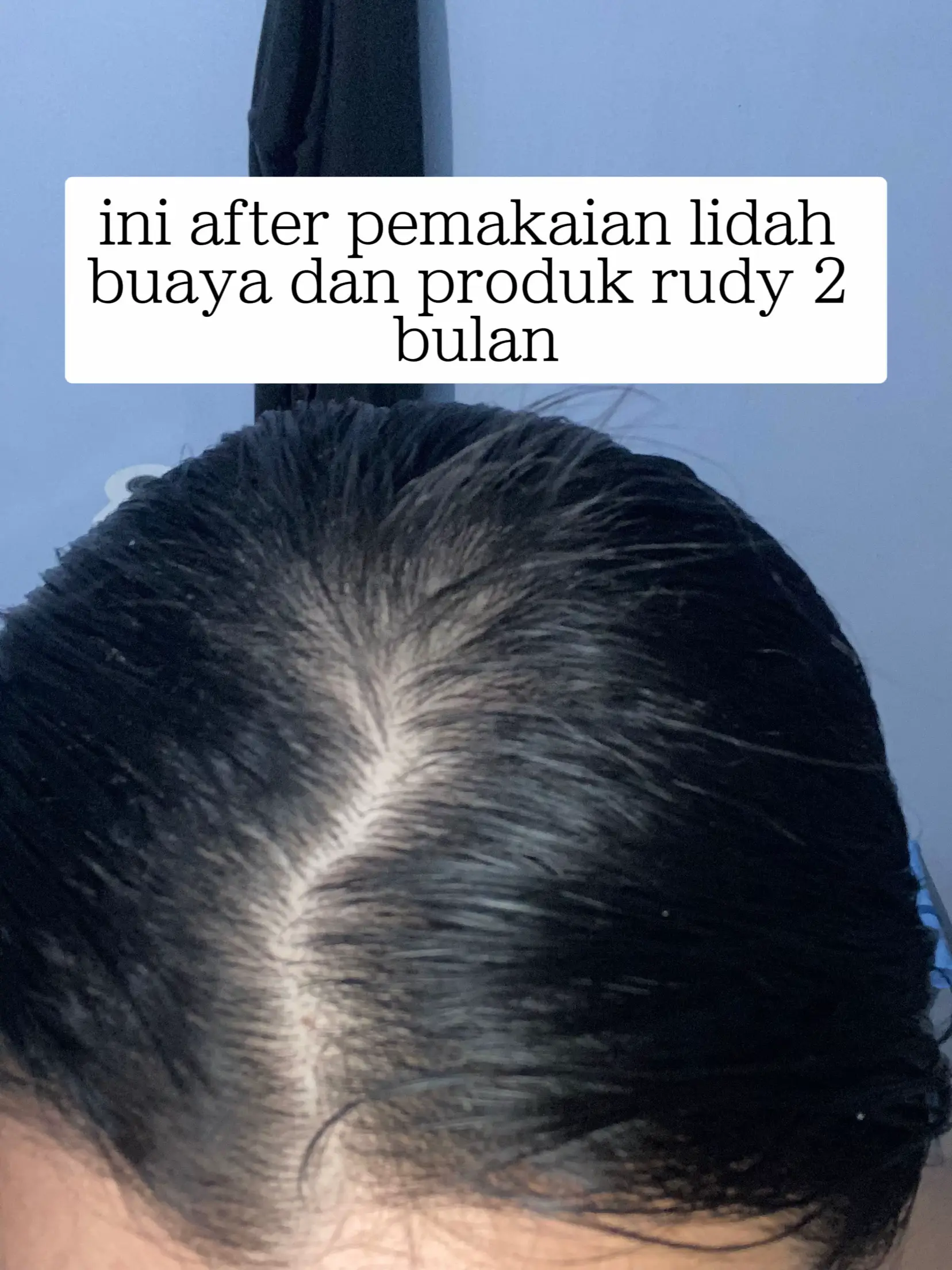 RAMBUT MEMBOTAK KARENA RONTOK? INI SOLUSINYA! | Galeri diposting oleh fey | Lemon8