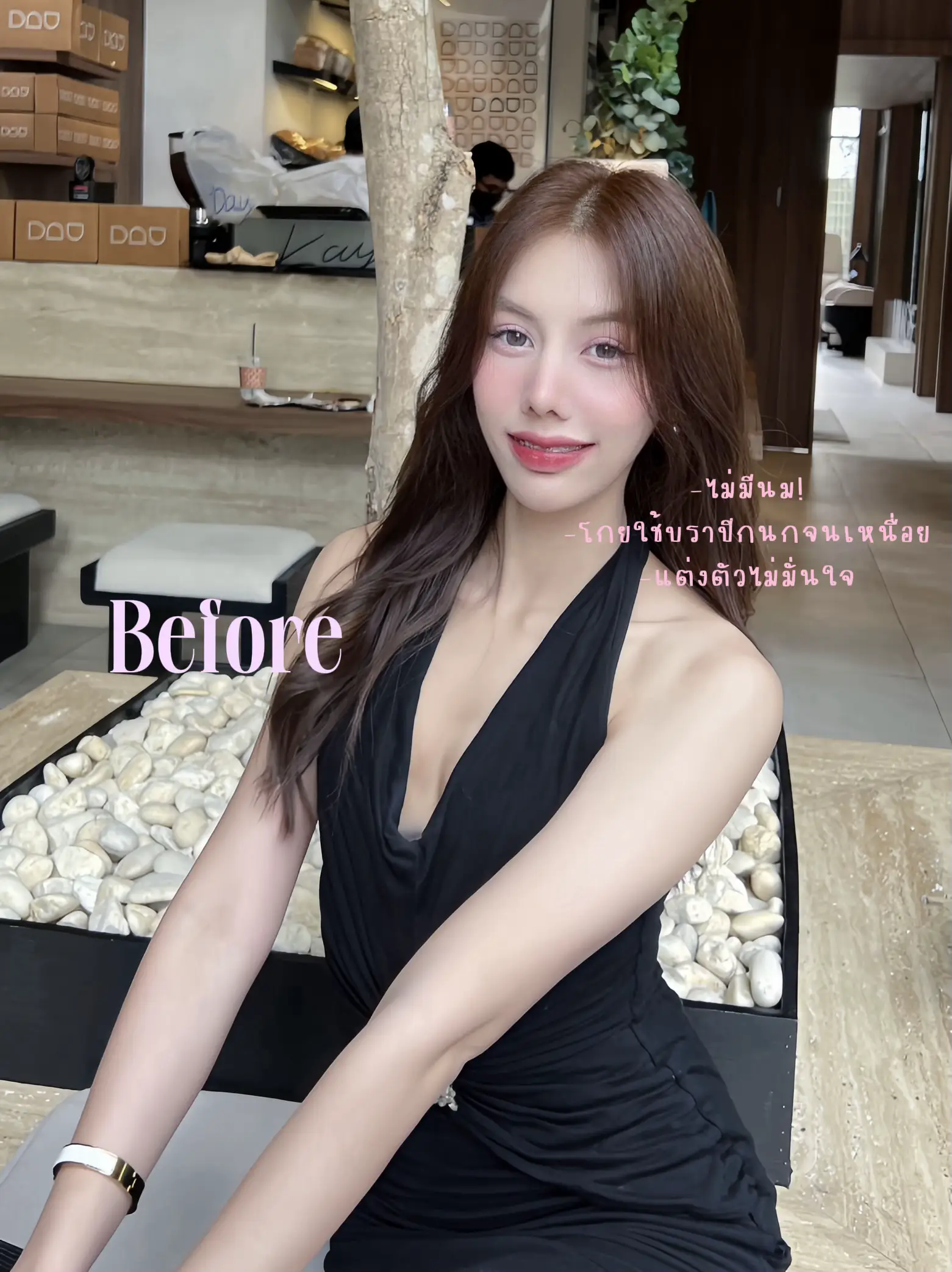 รีวิวเสริมหน้าอกครั้งแรกในชีวิต🎀💕 | แกลเลอรีที่โพสต์โดย Muham | Lemon8