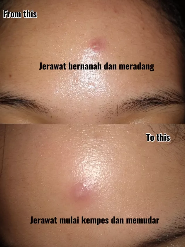 JERAWAT dan Bekas Jerawat Hilang | Galeri diposting oleh muty | Lemon8