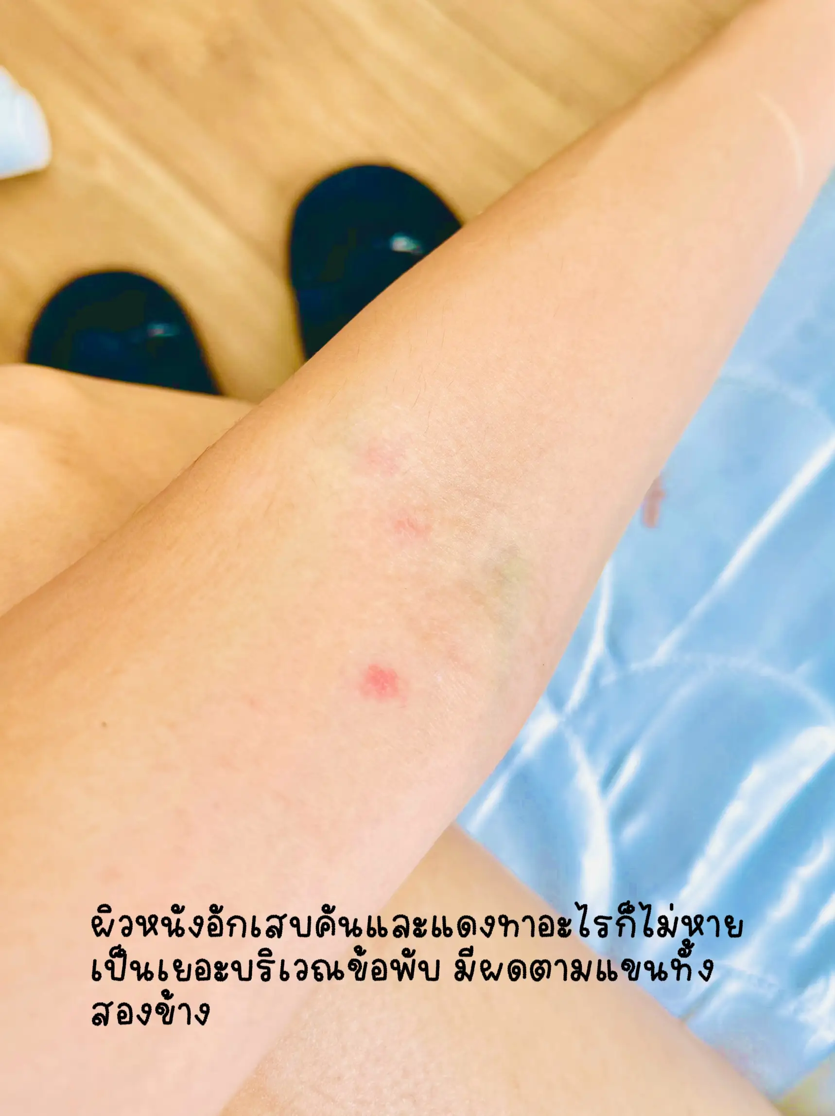 ภูมิแพ้ ผิวหนังอักเสบ ในวัย34 | แกลเลอรีที่โพสต์โดย Ployz | Lemon8