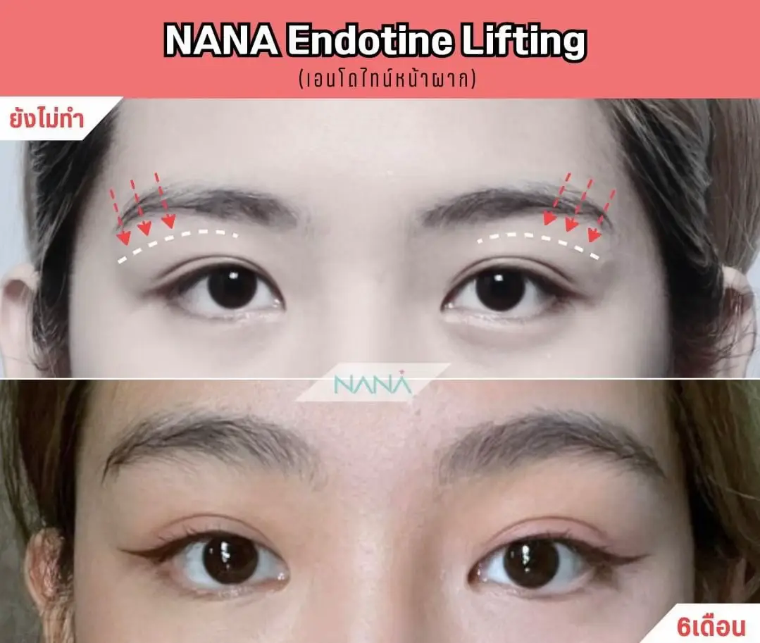 อย่าเพิ่งทำตา หากยังไม่รู้จัก Endotine(ยกหน้าผาก) | แกลเลอรีที่โพสต์โดย Noom BTF | Lemon8