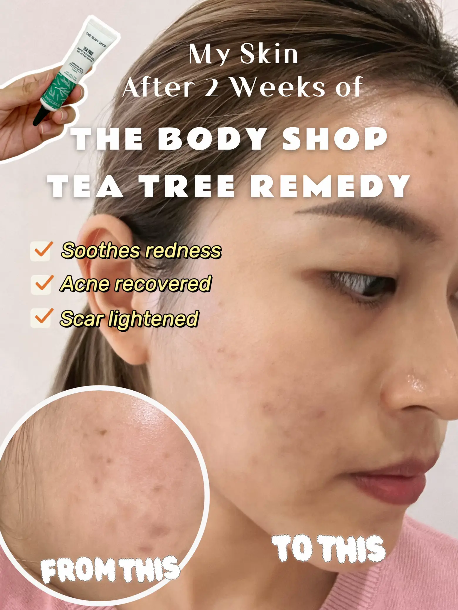 My Skin After 2 weeks of Tea Tree Remedy🌿 | Galeri disiarkan oleh ...