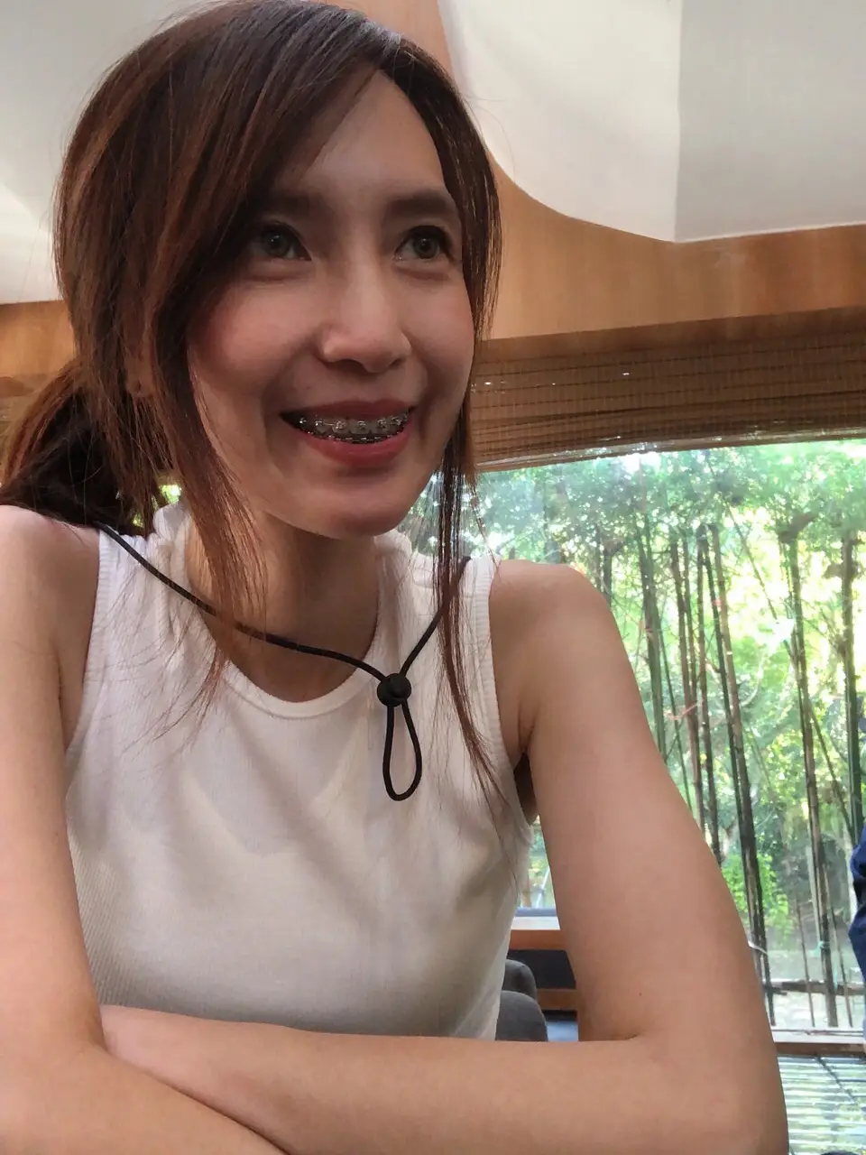 Ep.4 ครบ 3 เดือน หลังผ่าตัดขากรรไกร หน้าเข้าที่ เป๊ะเวอร์😃 | แกลเลอรีที่โพสต์โดย PpSAmE | Lemon8